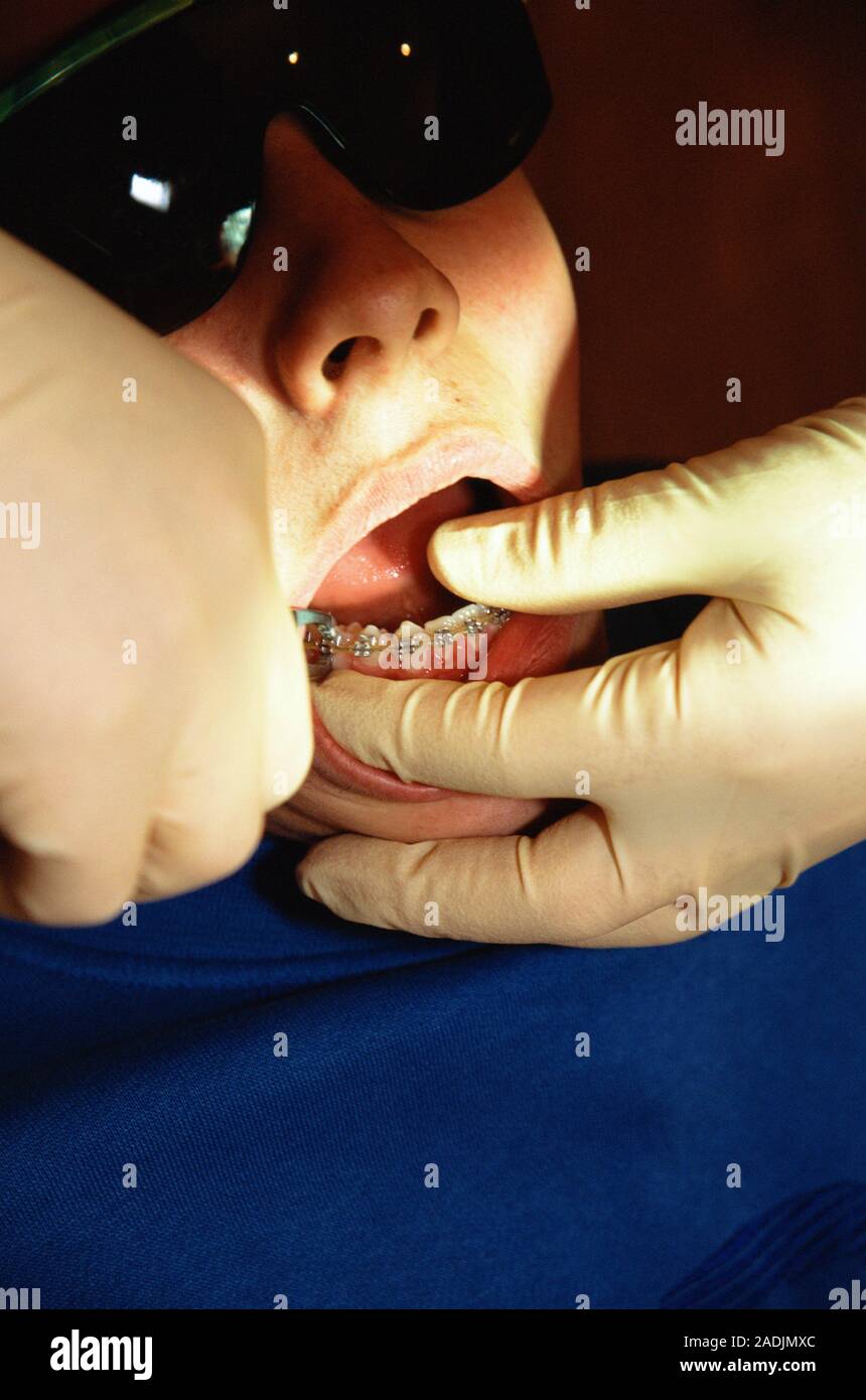 Orthodontic brace removal. Removal of an orthodontic brace that has ...