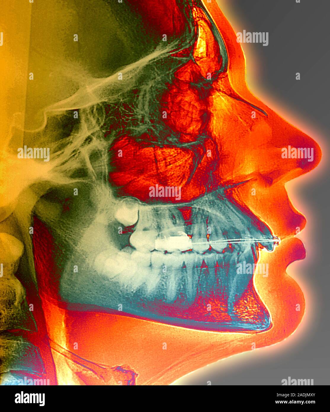 Orthodontic brace. Coloured X-ray of a patient's face in side view ...