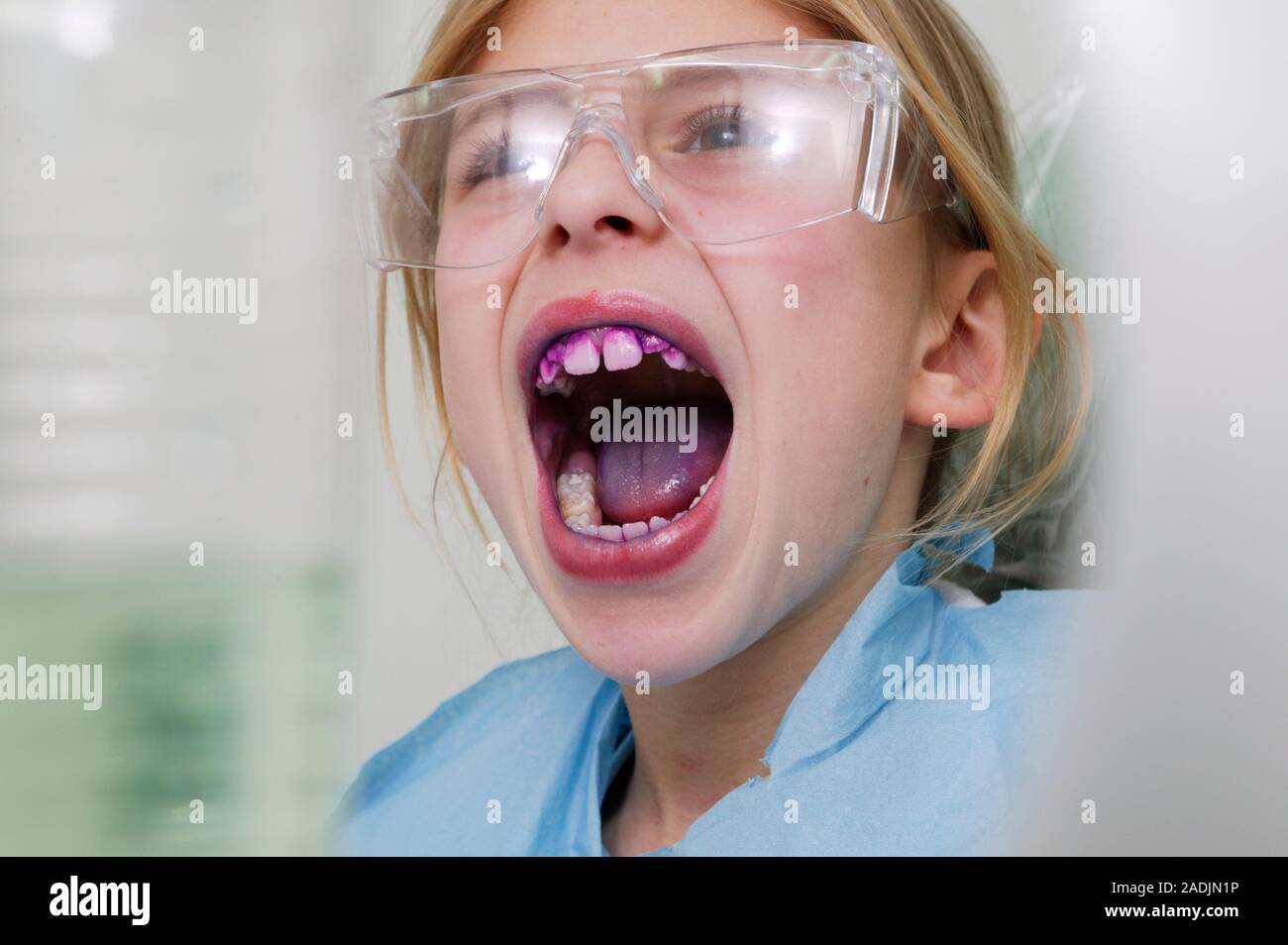 Plaque detection. Girl showing the plaque on her teeth revealed by a ...