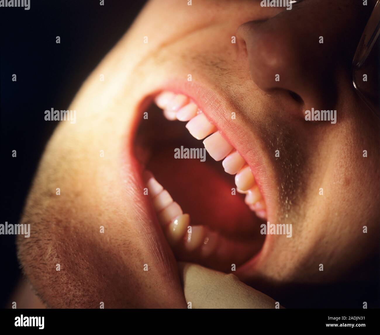 Plaque detection. Plaque on a male dental patient's teeth being ...