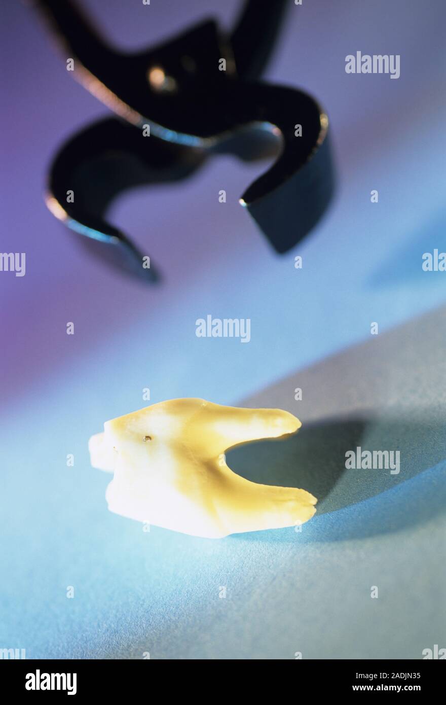 Tooth extraction. Conceptual image of a molar tooth and pliers to ...