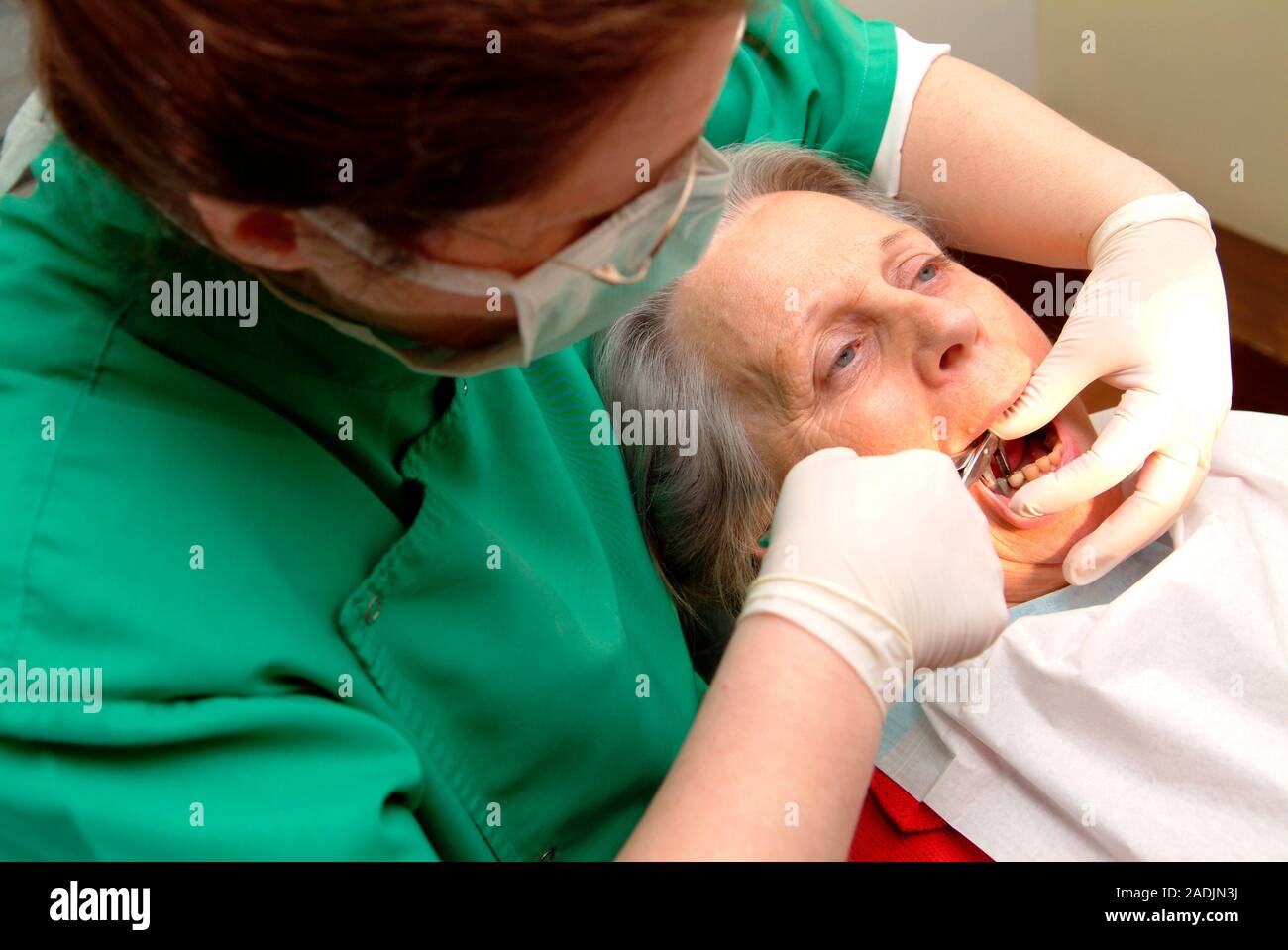 MODEL RELEASED. Tooth removal. Dentist removing a tooth from a female ...