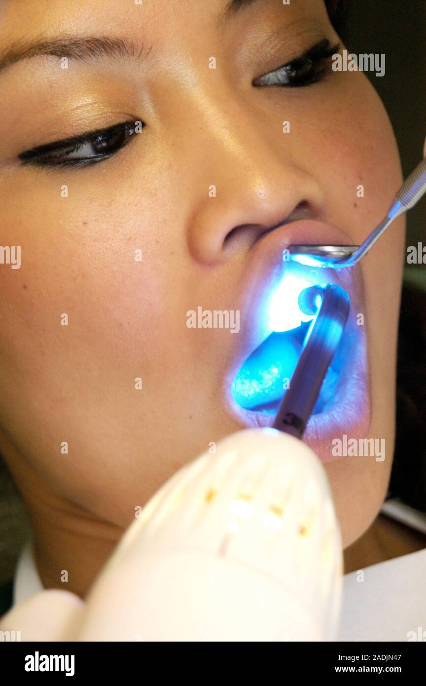 MODEL RELEASED. Dental treatment. Ultraviolet light being used to set a ...