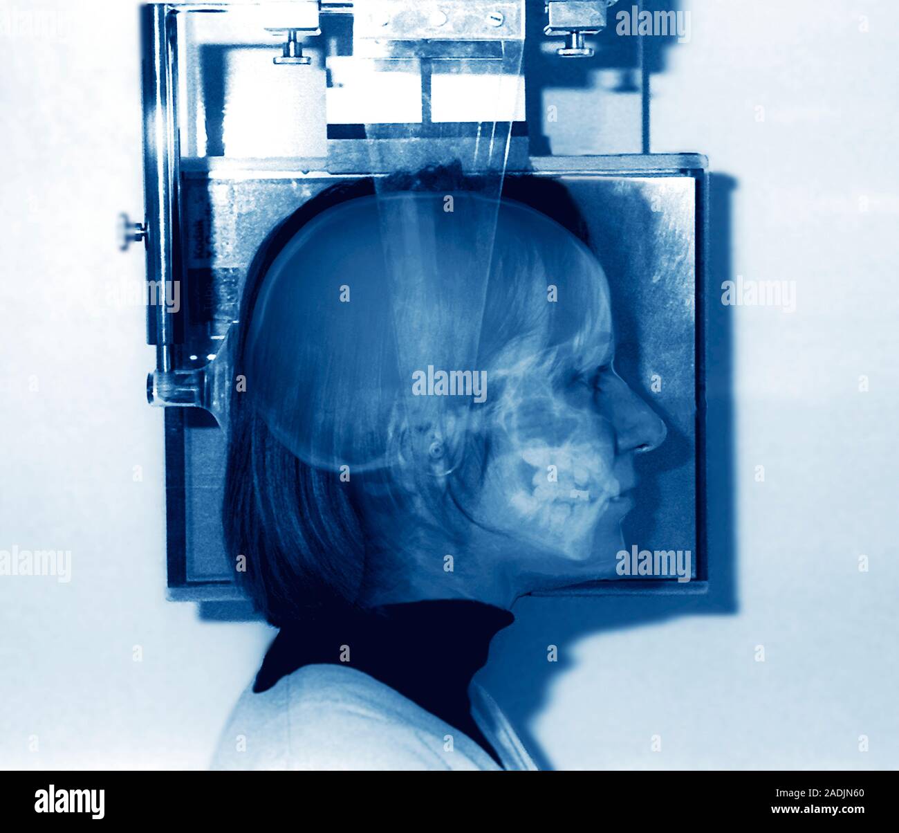 Jaw X-ray. Coloured cephalogram (jaw X-ray) superimposed on a ...