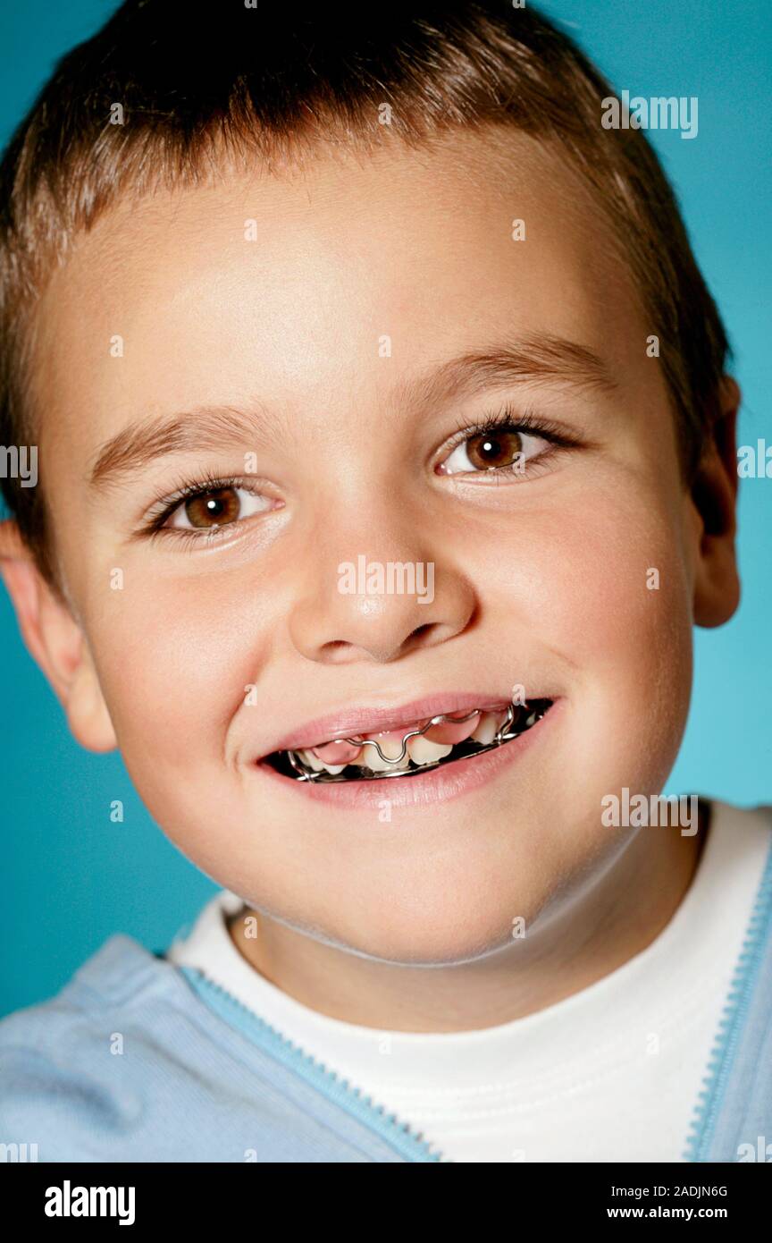 MODEL RELEASED. Young boy wearing a dental retainer. A dental retainer ...