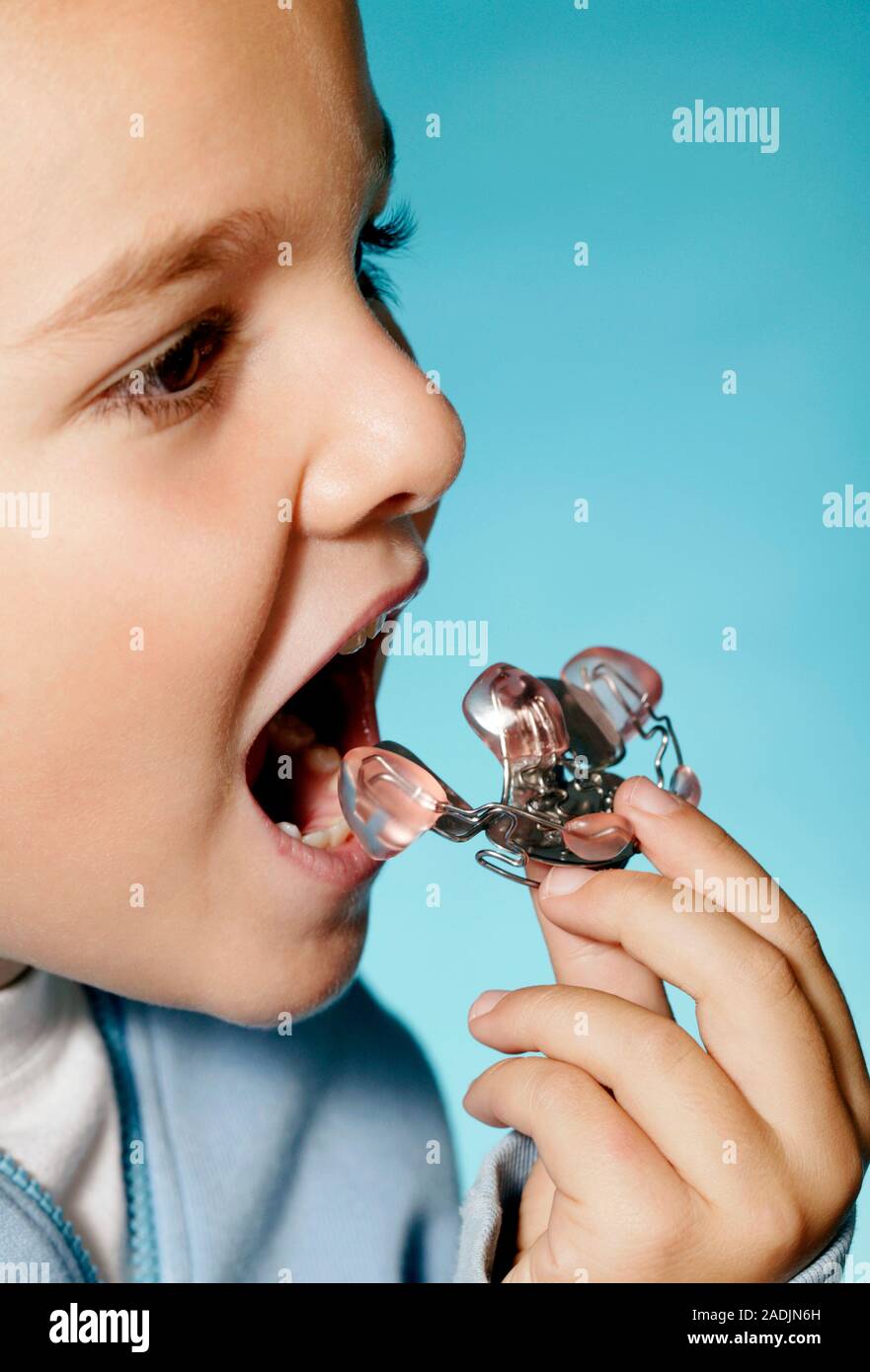 MODEL RELEASED. Young boy with a dental retainer. A dental retainer is ...