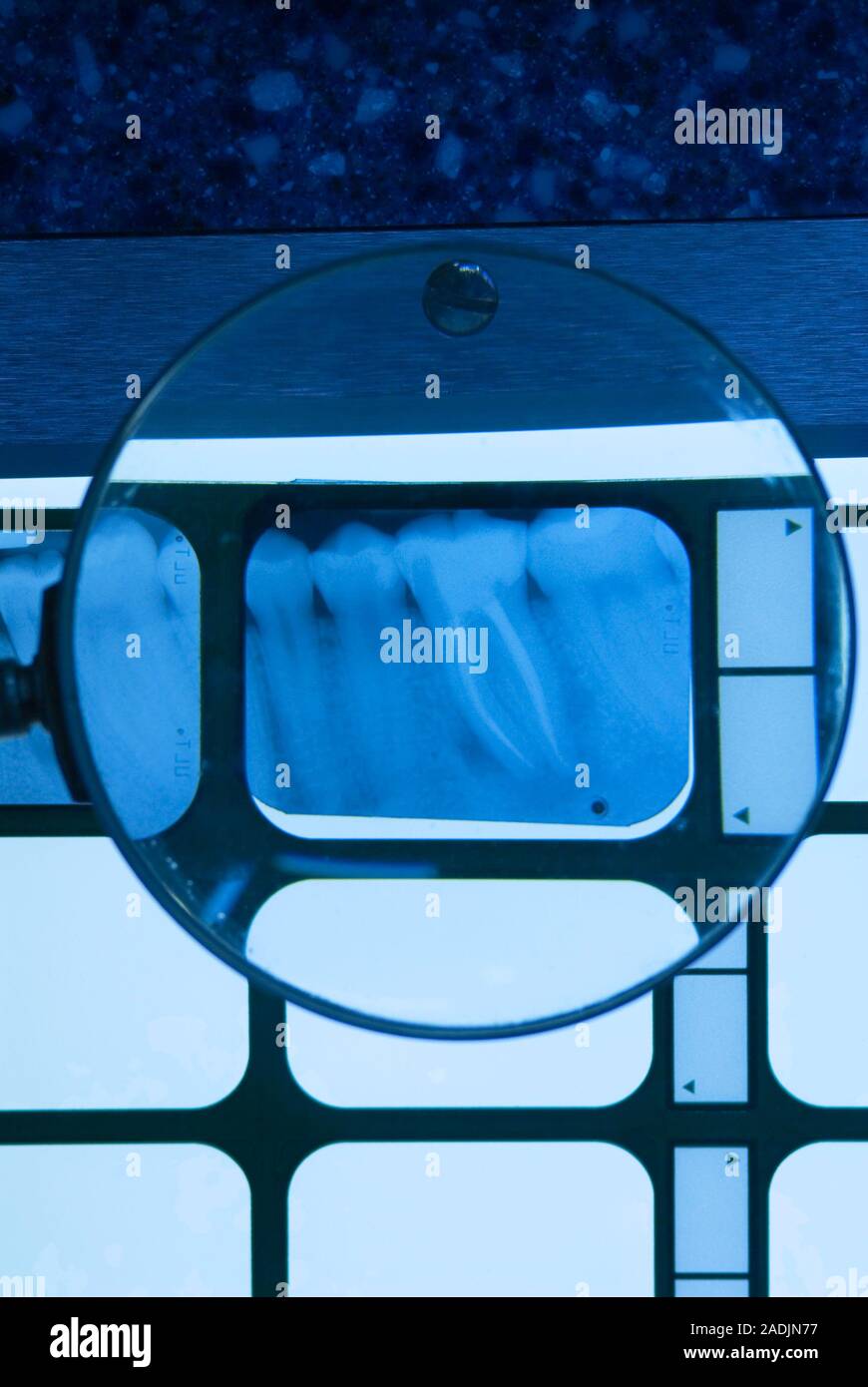 Root canal dental X-ray. X-ray of a tooth filled during root canal ...