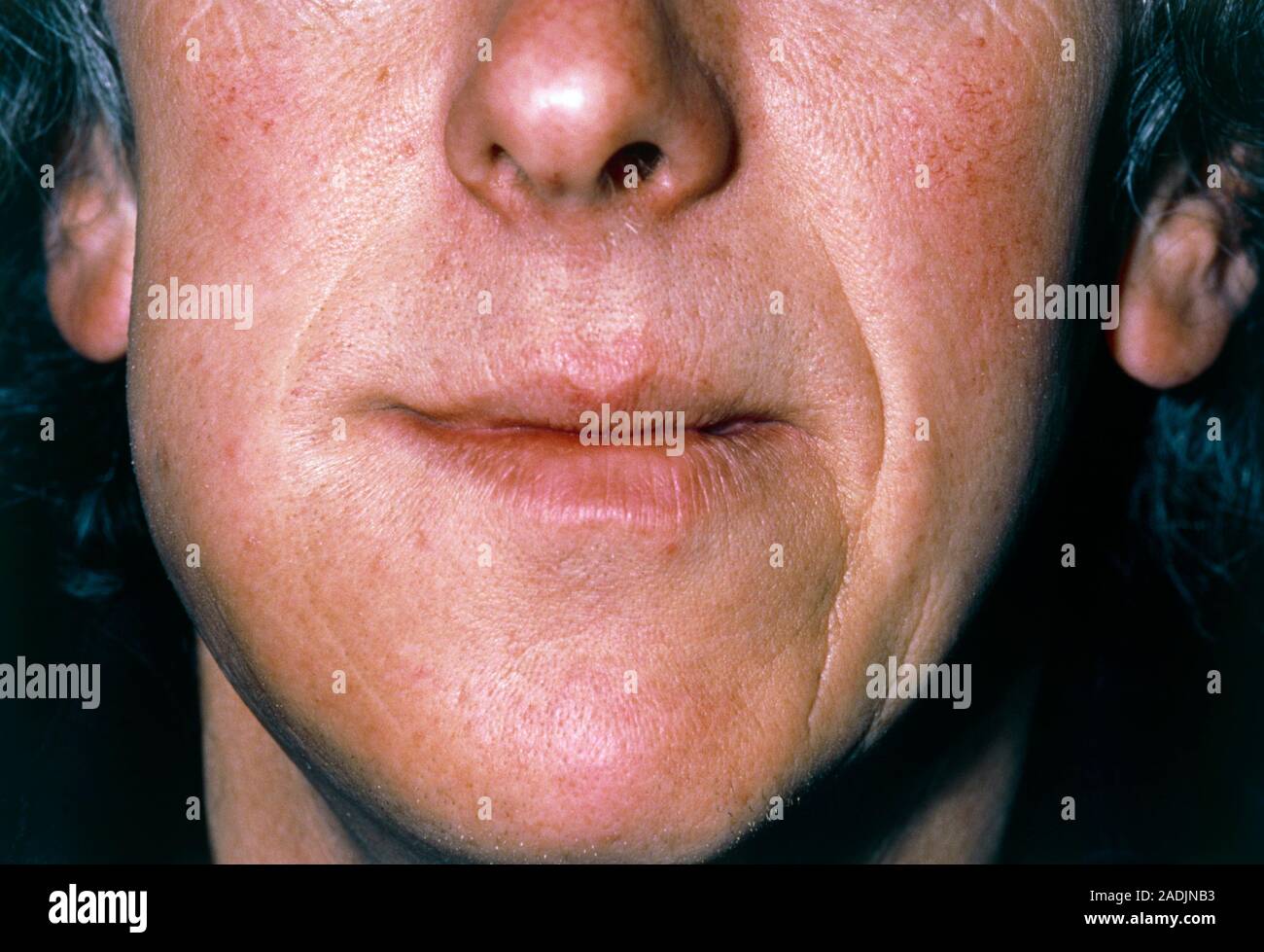 Dental abscess. External view of the mouth of a patient suffering from ...