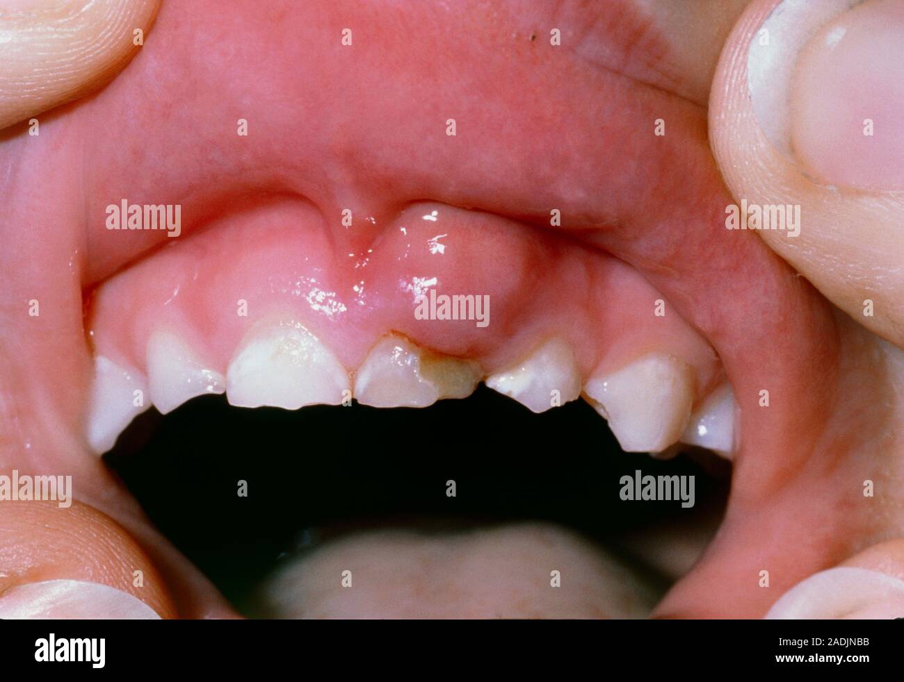 Dental abscess. Close-up of a dental abscess over a milk tooth on a ...