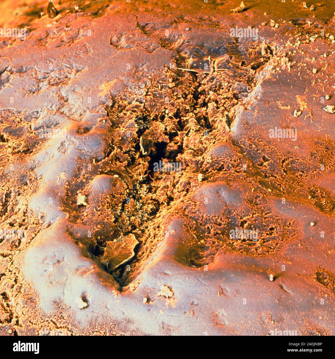 Tooth decay. Coloured Scanning Electron Micrograph (SEM) of a hole (a ...