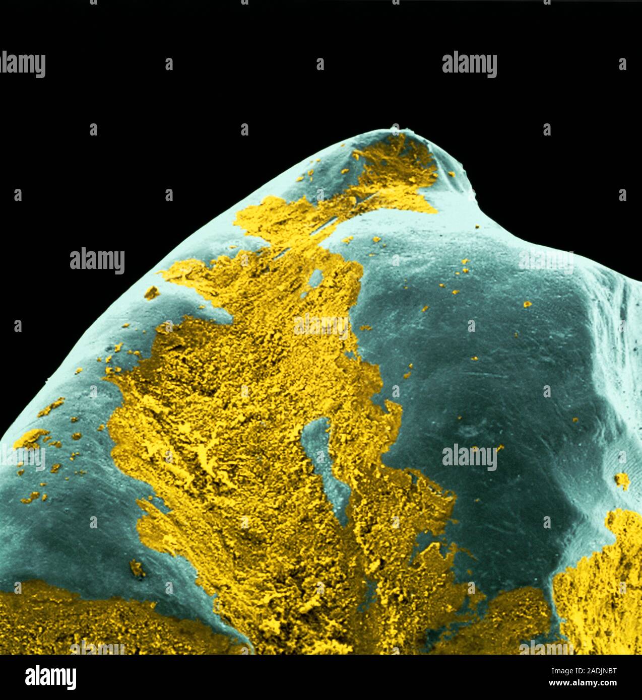 Tooth plaque (Image 1 of 4). Coloured scanning electron micrograph (SEM ...