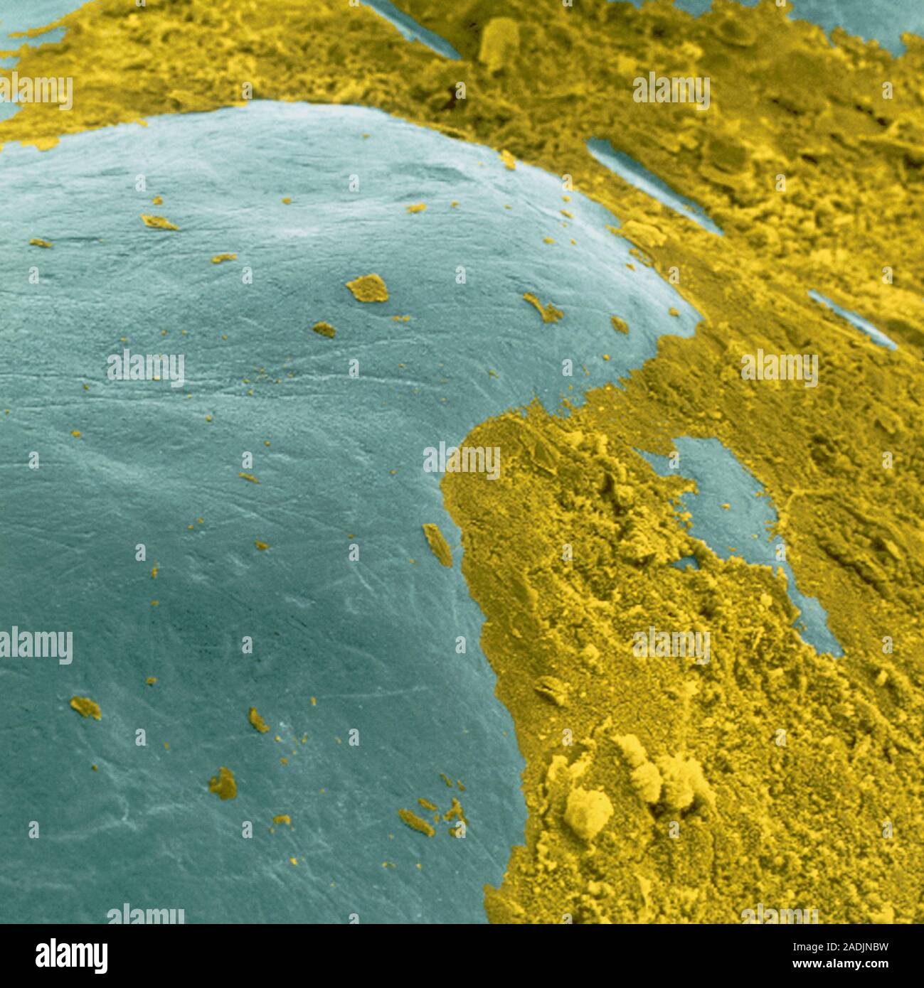 Tooth plaque (Second of four images). Coloured scanning electron ...