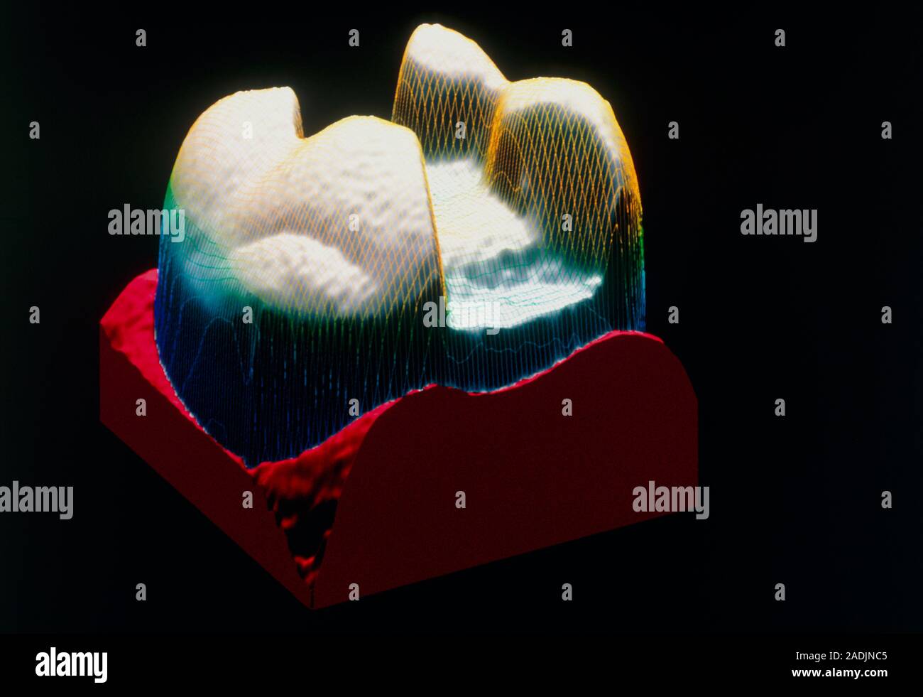 Dental inlay preparation. (Image 1 of 3). Computer graphic of a tooth ...