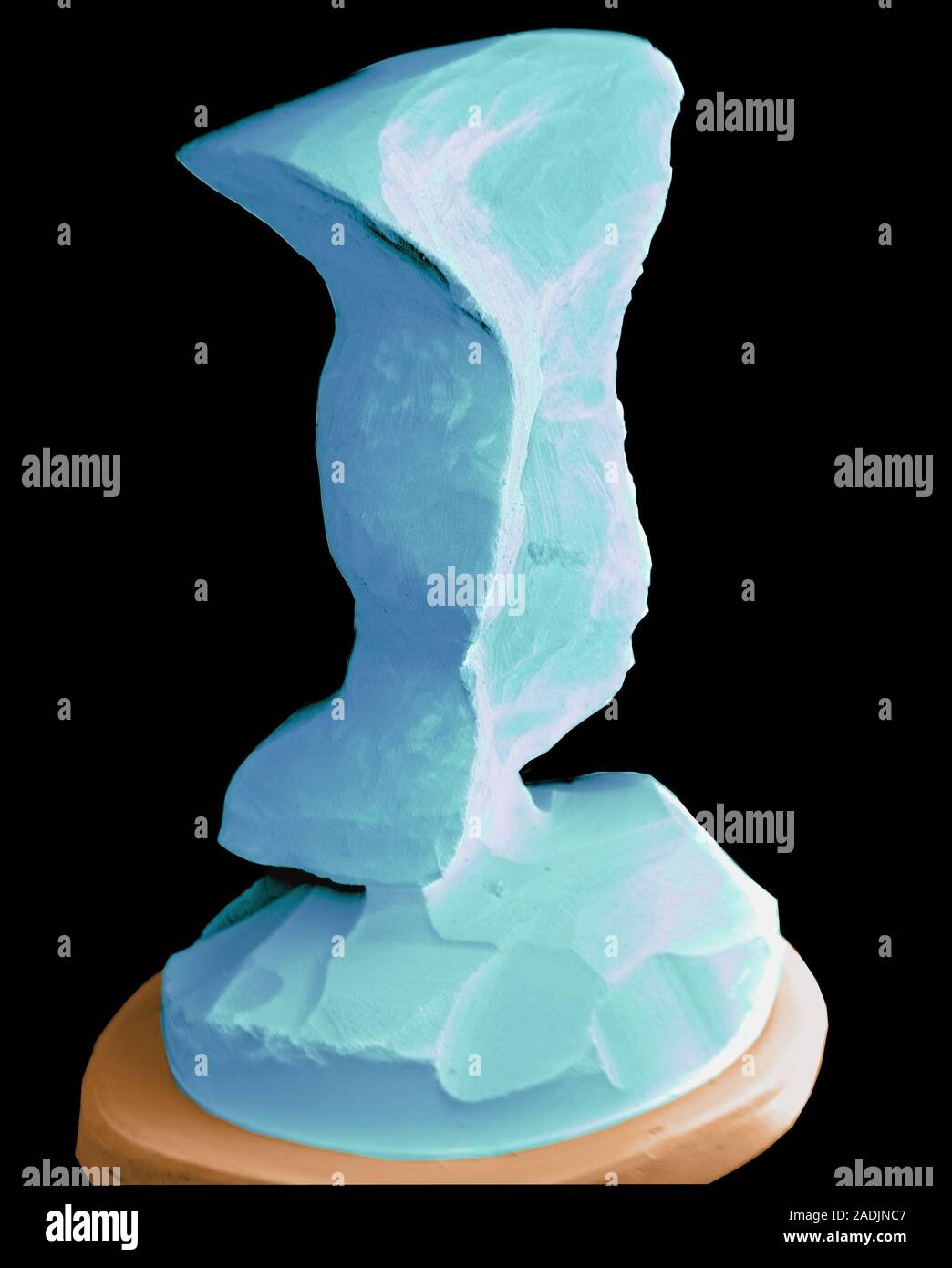 Dental inlay. (Image 3 of 3). Coloured scanning electron micrograph ...