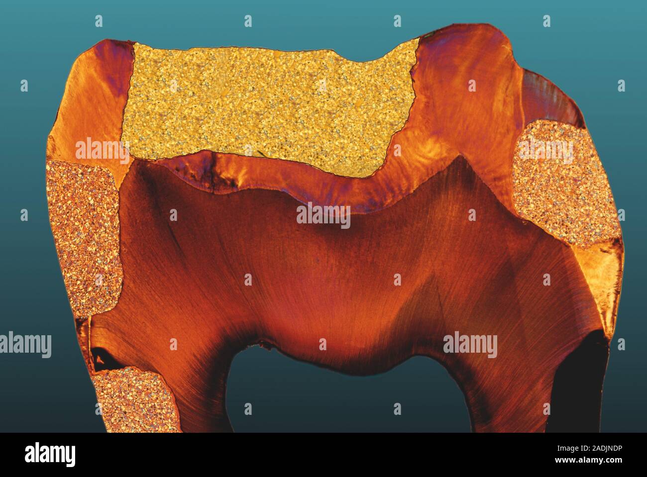 Tooth fillings. Polarised light micrograph (PLM) of a longitudinal ...