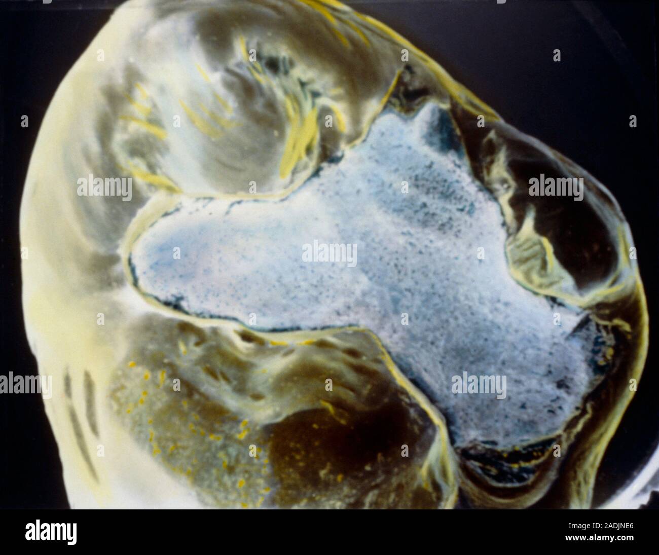 Tooth with filling. Coloured scanning electron micrograph (SEM) of a ...
