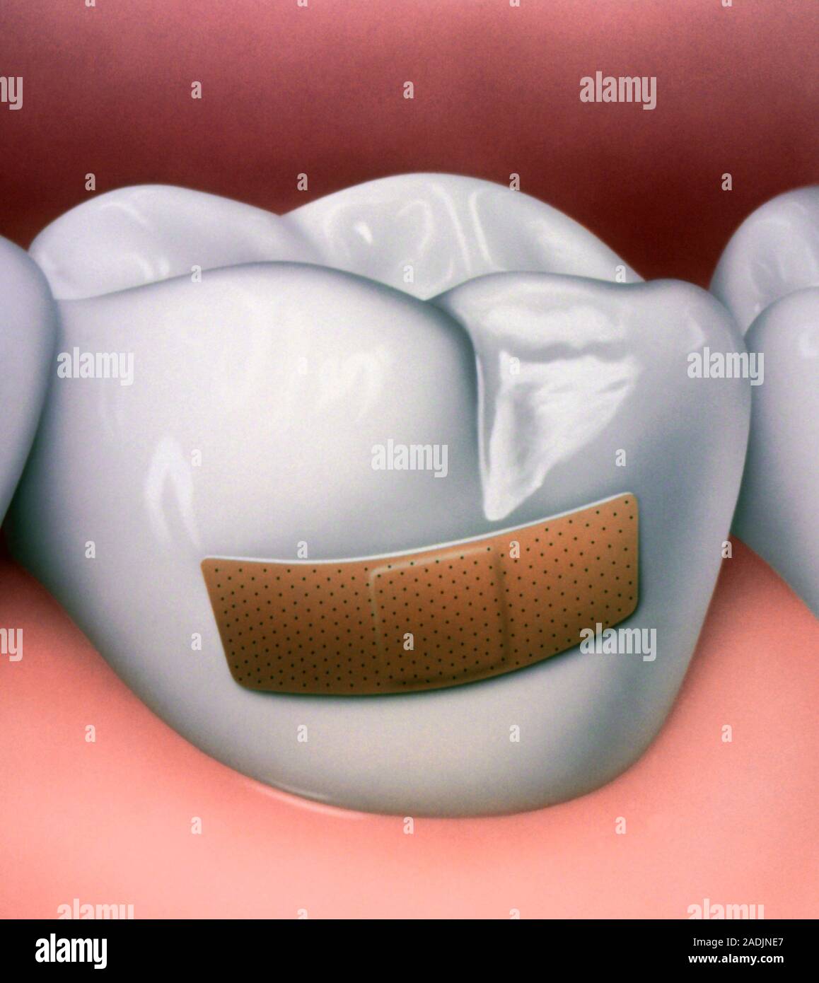 Tooth care. Conceptual artwork depicting care for teeth showing a ...