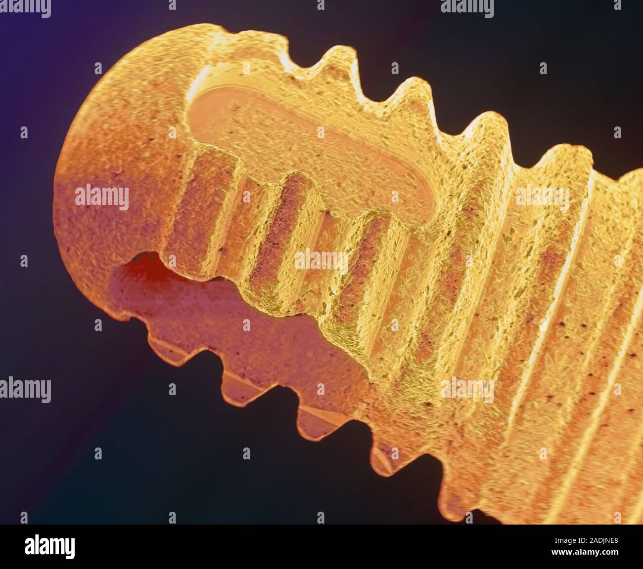 Dental implant. Coloured scanning electron micrograph (SEM) of part of ...