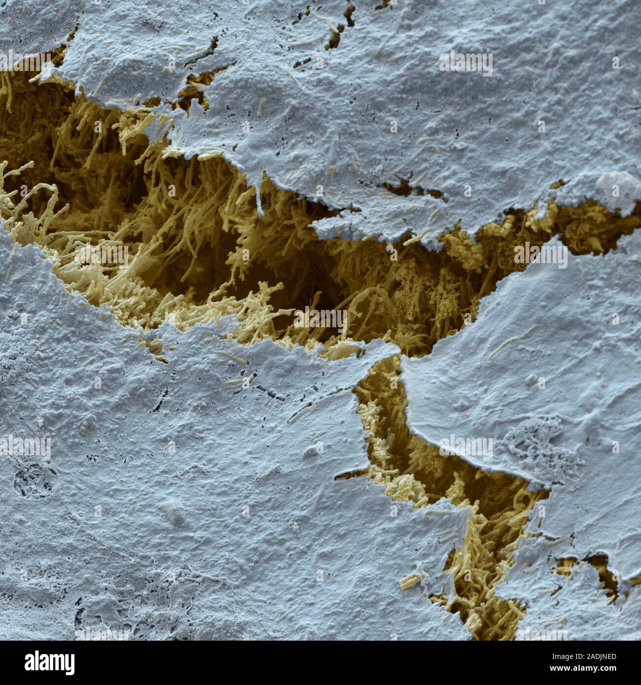 Tooth decay. Coloured scanning electron micrograph (SEM) of plaque ...
