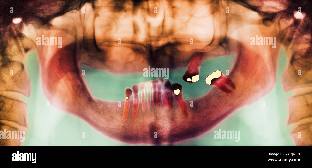 Loss of teeth. Coloured pan-oral X-ray of the mouth of an elderly man ...