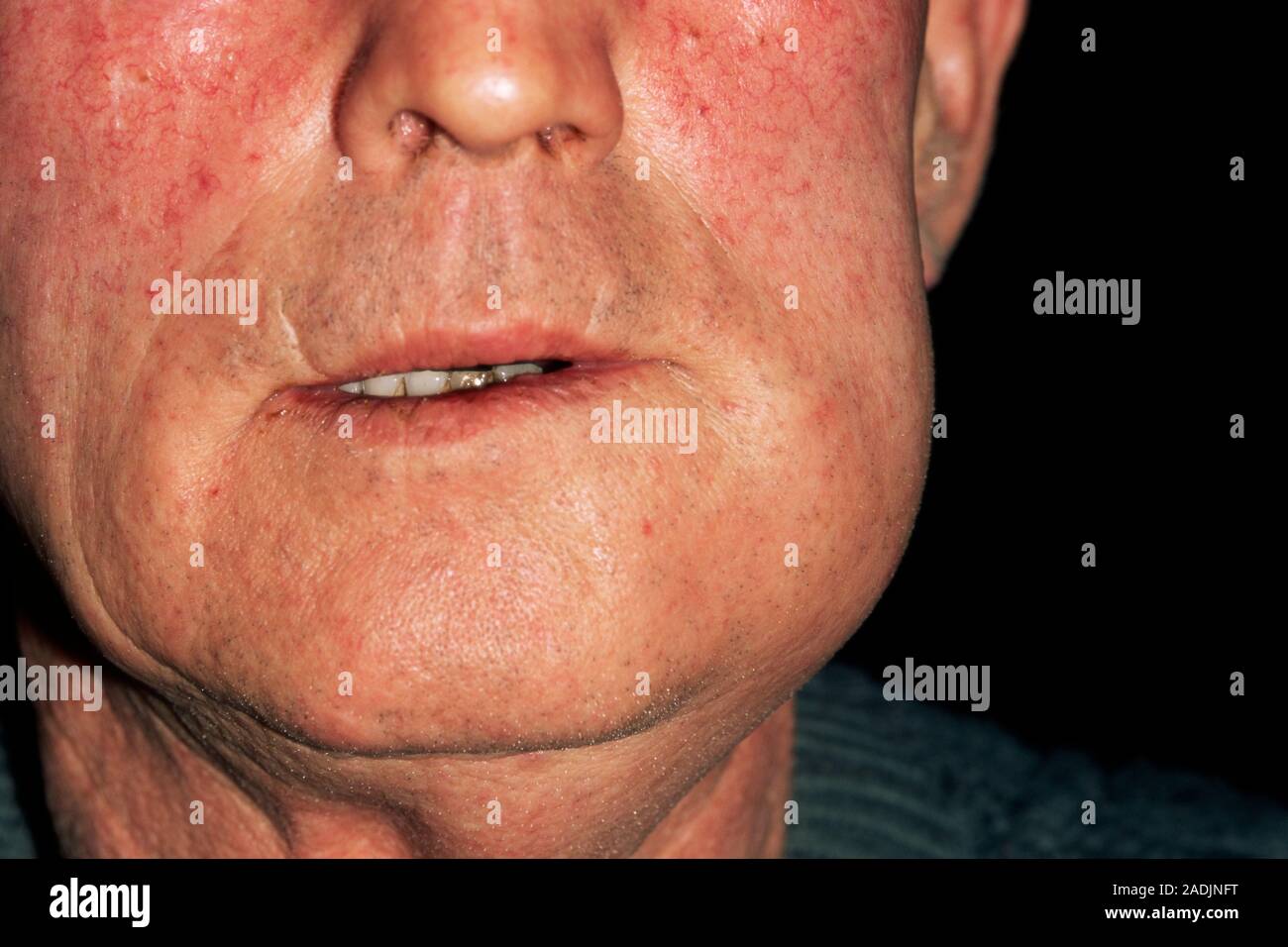 Dental abscess. 58-year-old man with a swollen jaw due to a dental ...