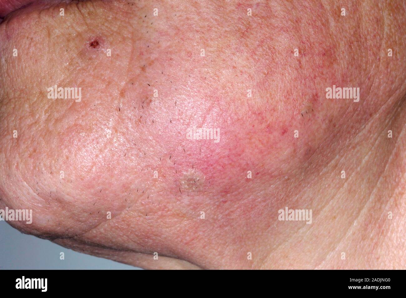 Dental abscess. Seventy-one year old woman with a swollen jaw due to a ...