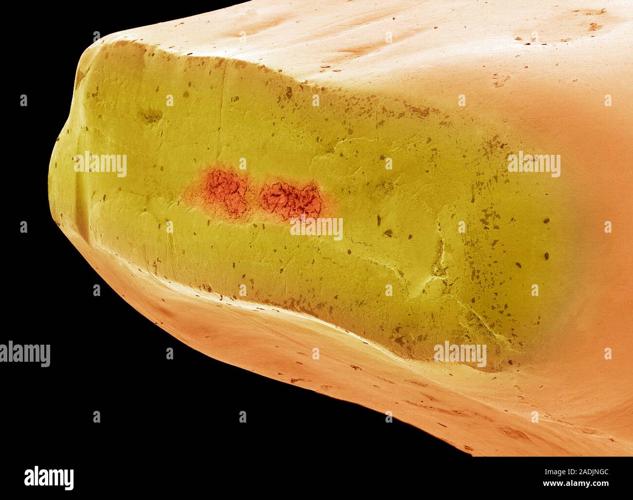 Tooth decay. Coloured scanning electron micrograph (SEM) of cavities ...