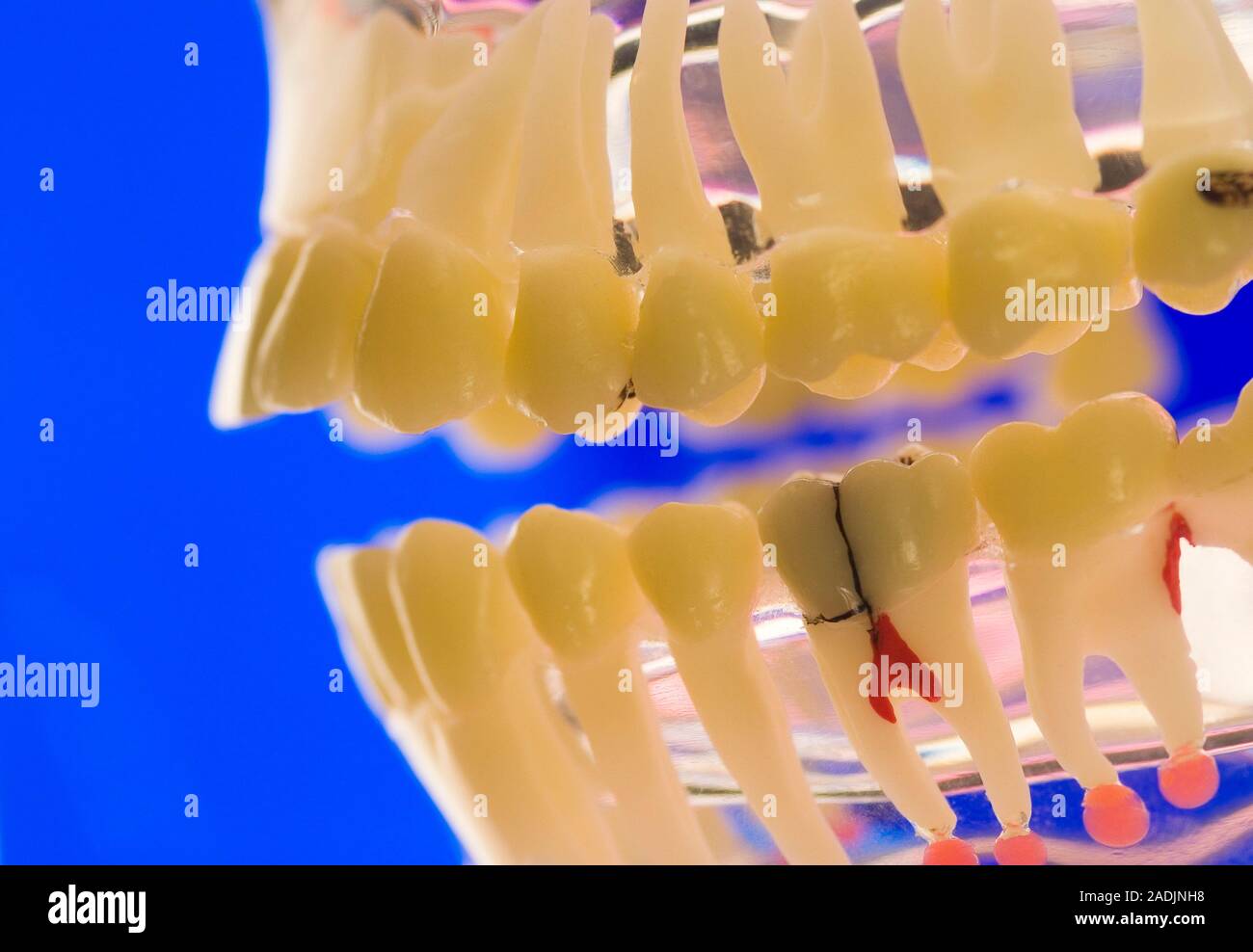 Tooth decay, dental model. This model show the teeth of the upper and ...