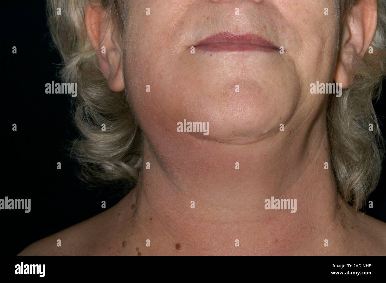 Dental abscess (swelling at upper left) affecting the right side of a ...