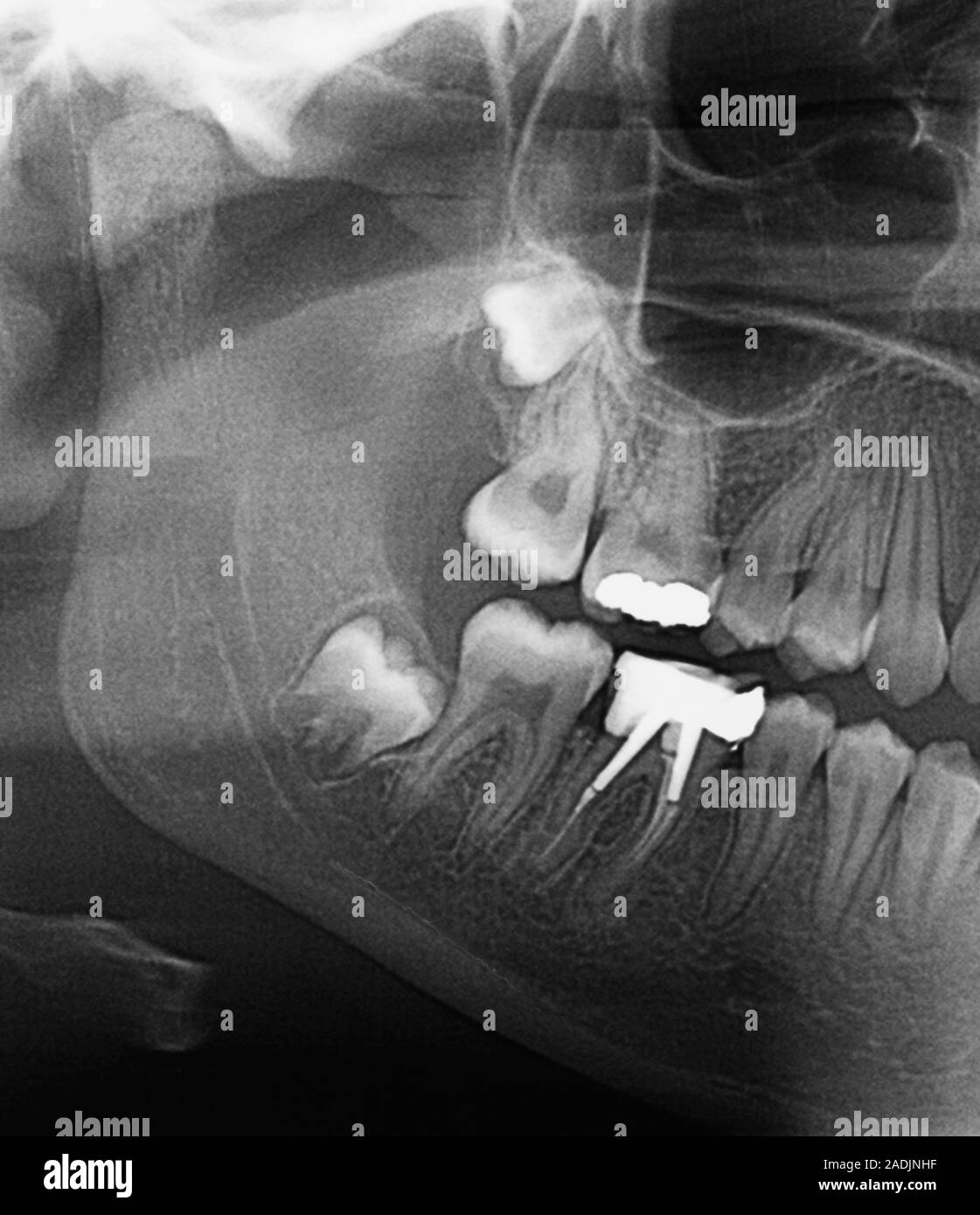 Impacted wisdom tooth. X-ray of an 18 year old's jaw showing an ...