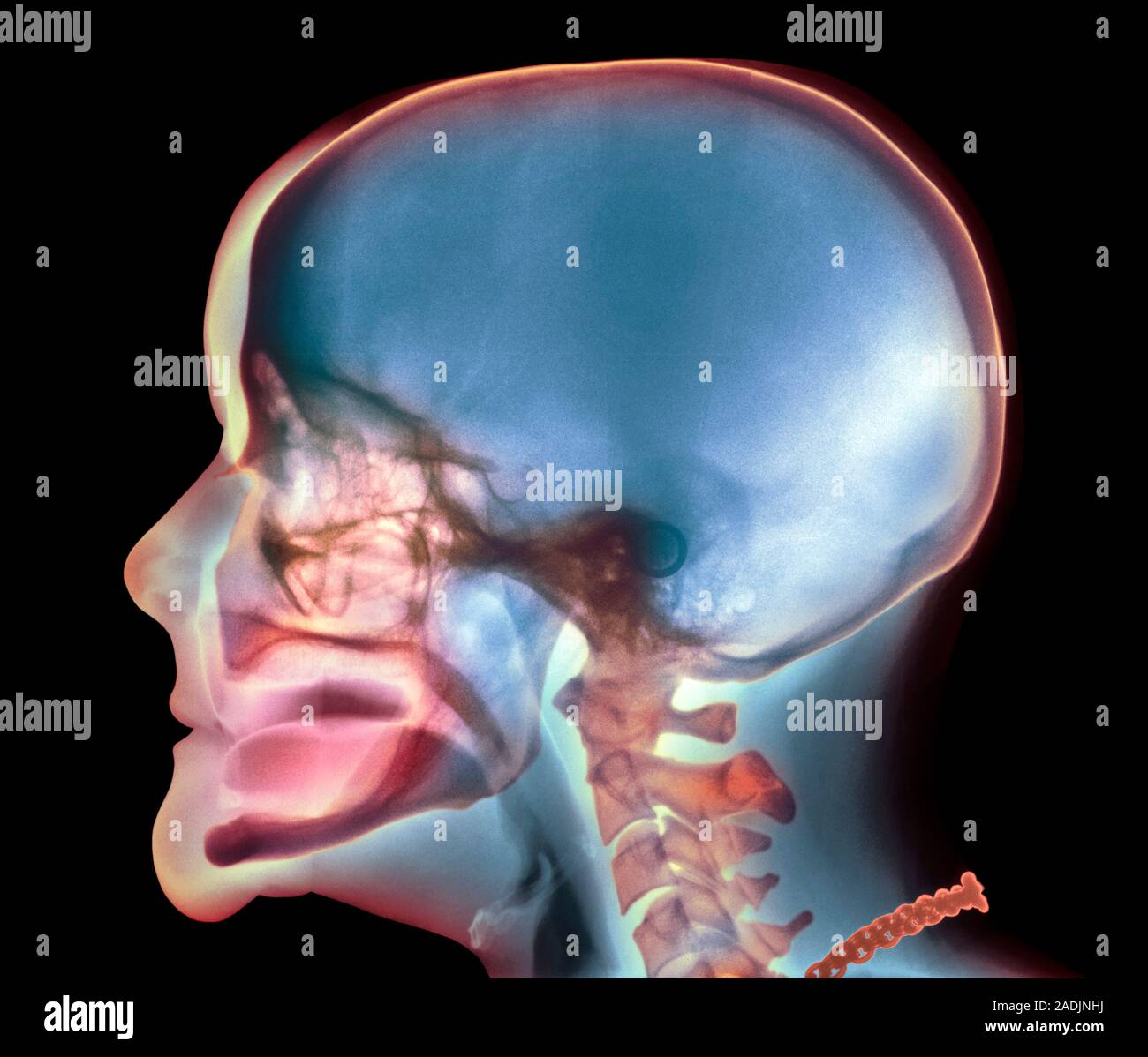 Loss of teeth. Coloured X-ray (side view) of the head of a 49 year old ...