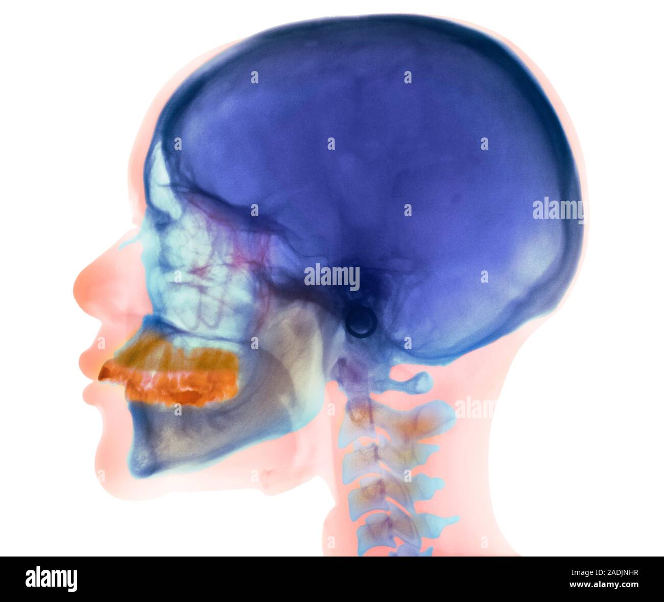 Overbite. Coloured X-ray (side view) of the head of a 32 year old woman ...