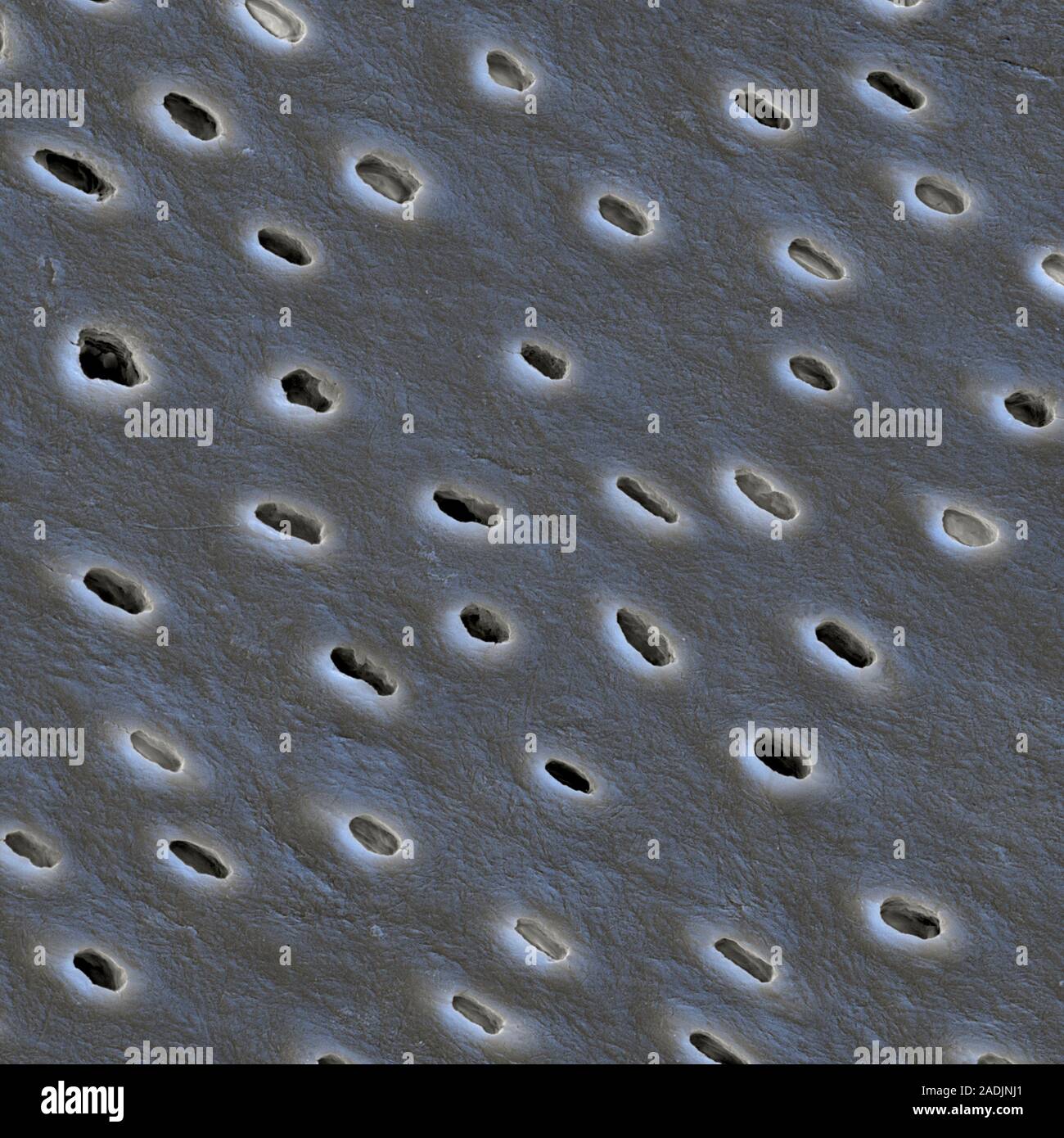 Sensitive tooth. Coloured scanning electron micrograph (SEM) of the ...