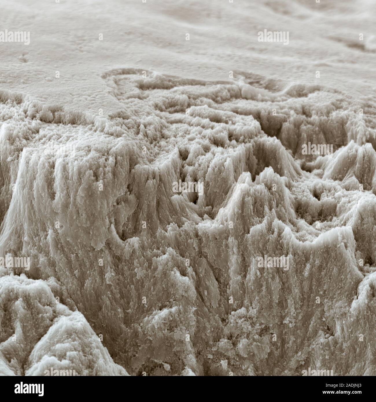 Tooth decay. Coloured scanning electron micrograph (SEM) of a decaying ...