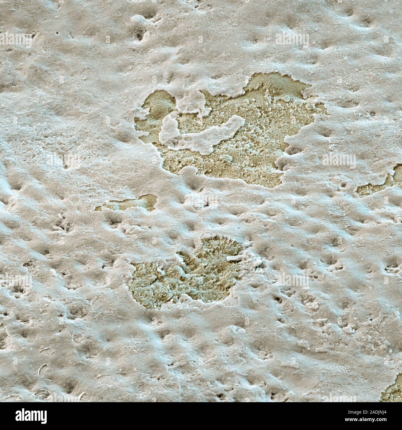 Tooth decay. Coloured scanning electron micrograph (SEM) of a decaying ...