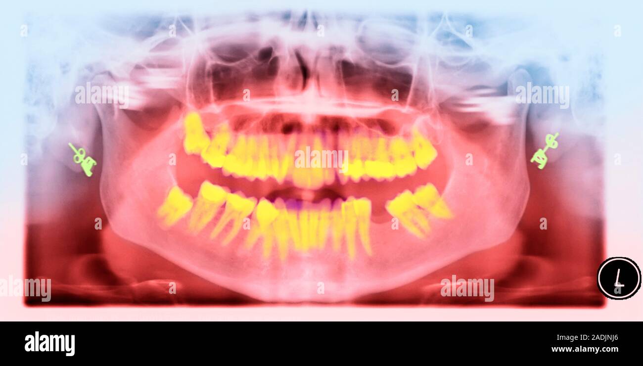 Missing teeth. Coloured pan-oral X-ray of the mouth of a female ...