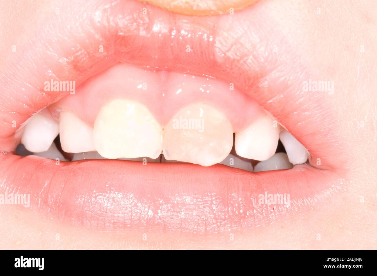 Dead front tooth. Three year old boy with a discoloured front incisor ...