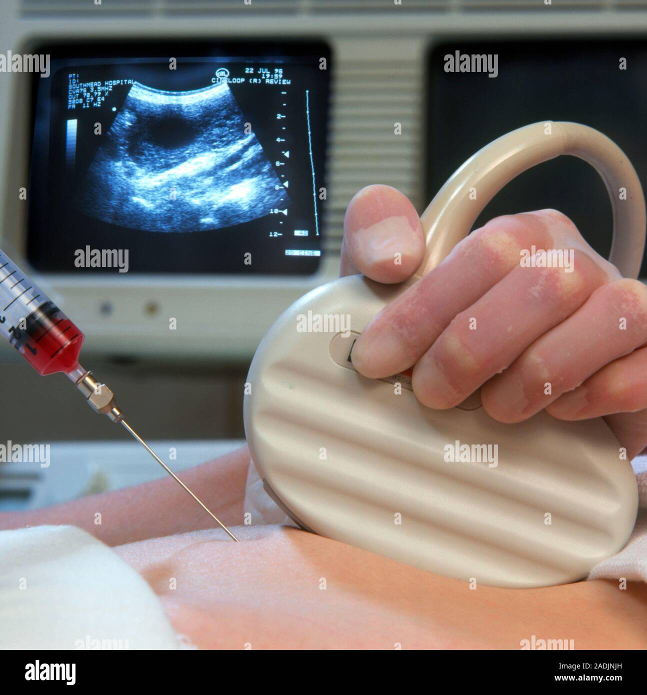 Chorionic villus sampling. Doctor's hand holds an ultrasound emitter ...