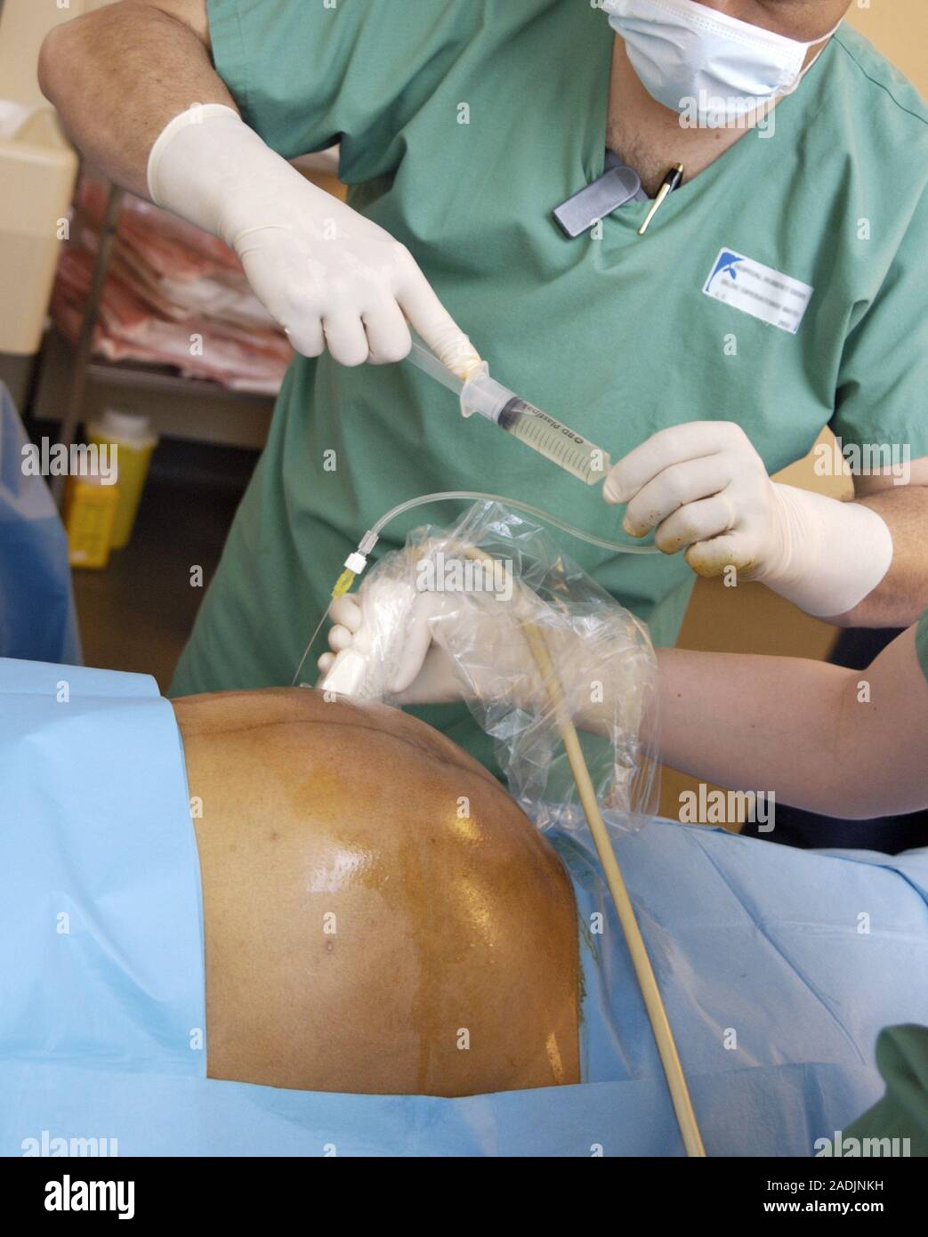 Amniocentesis. Obstetrician performing an amniocentesis test on a 34 ...