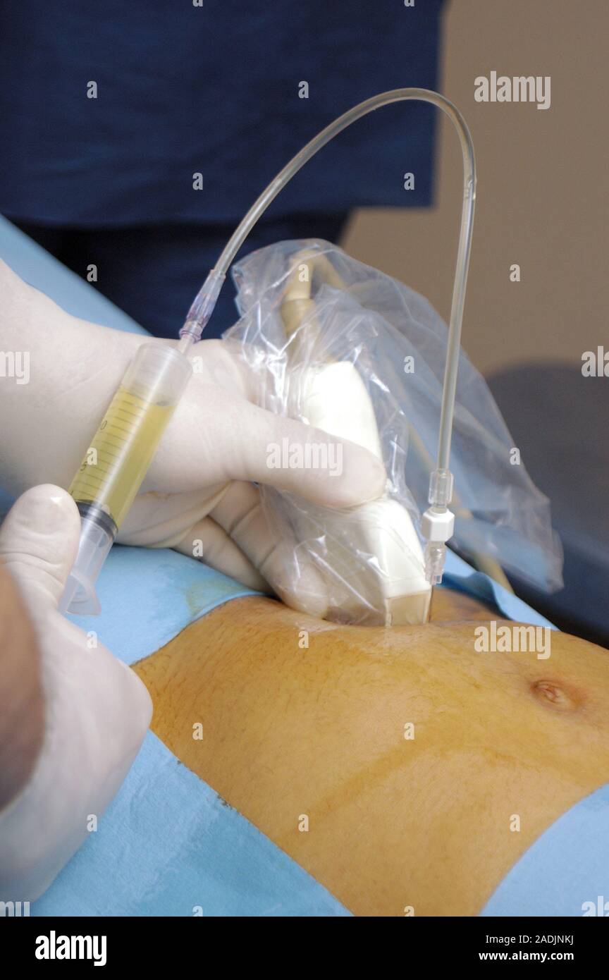 Amniocentesis. Obstetrician performing an amniocentesis test on a 14 ...