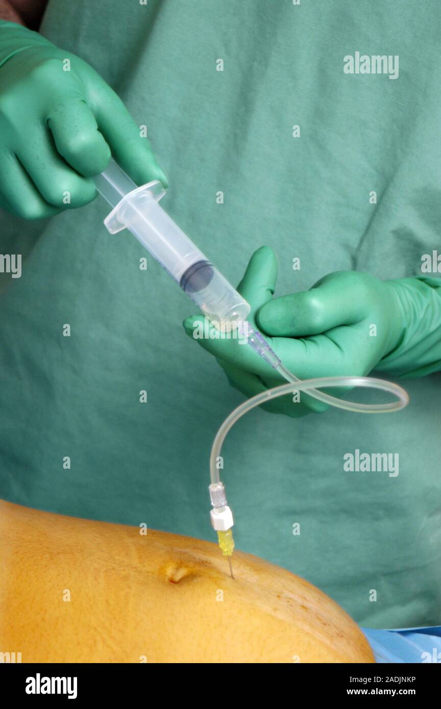 Amniocentesis. Obstetrician performing an amniocentesis test on a 20 ...