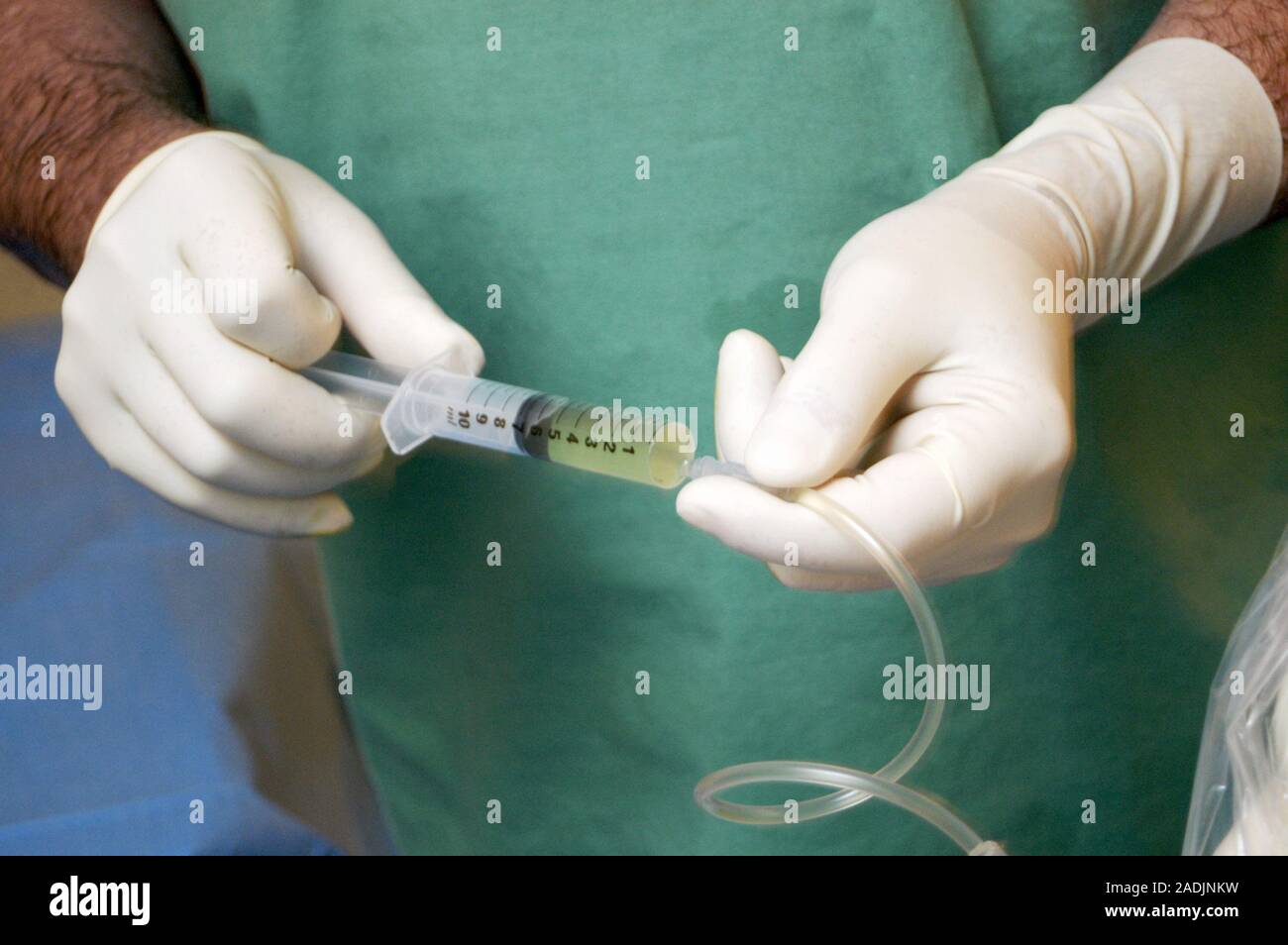 Amniocentesis. Obstetrician holding a syringe of amniotic fluid during ...