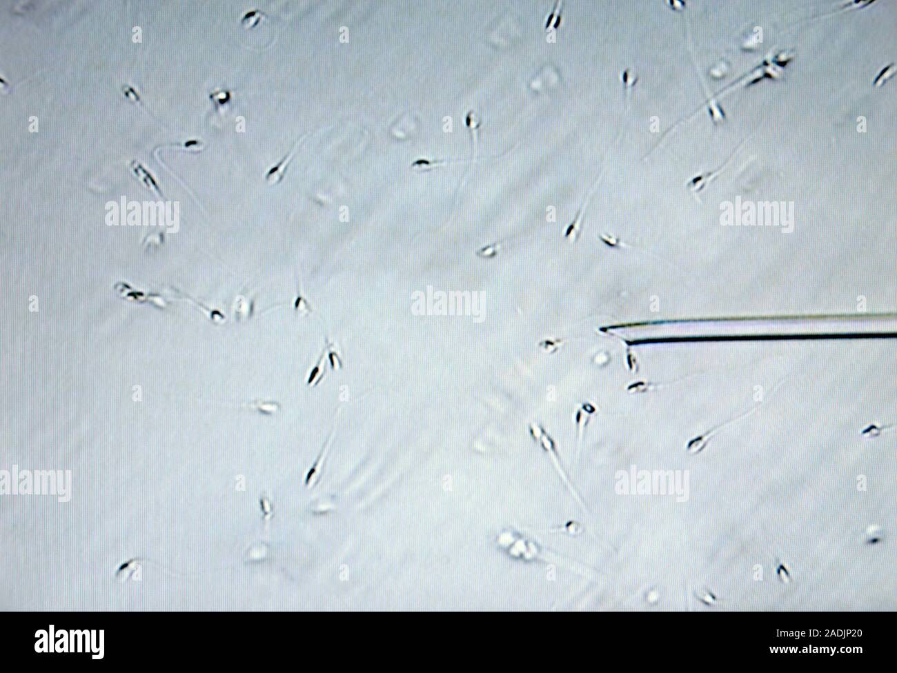 IVF treatment. Light micrograph of human sperm being sucked into a ...
