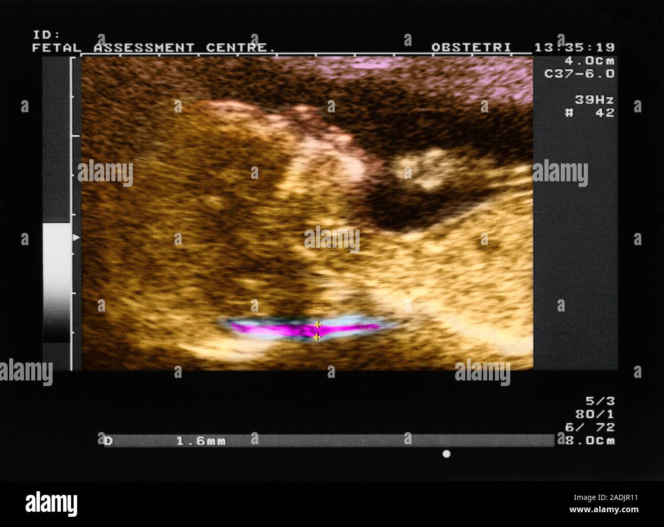 Nuchal Translucency Test Coloured Ultrasound Scan Of The Head And Neck
