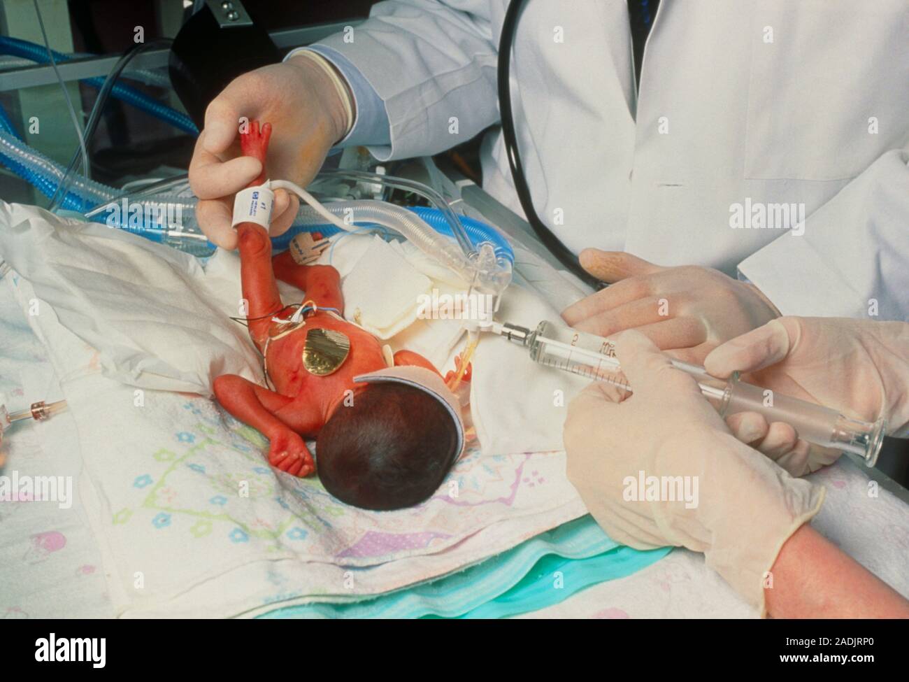 PFC fluid treatment of lungs. Premature baby is seen receiving PFC ...