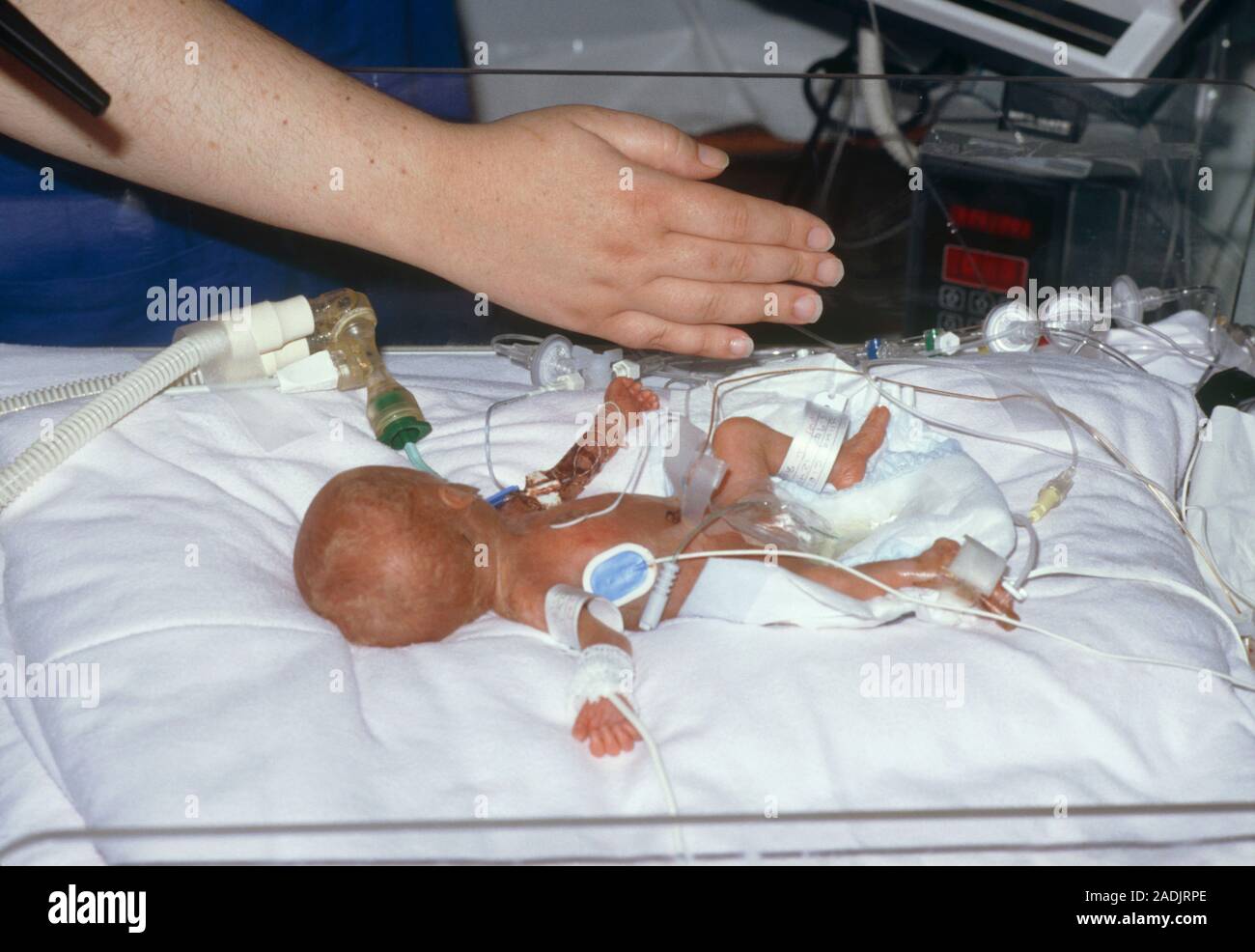 Premature baby. A premature baby in an intensive care unit with a nurse's hand to indicate the ...