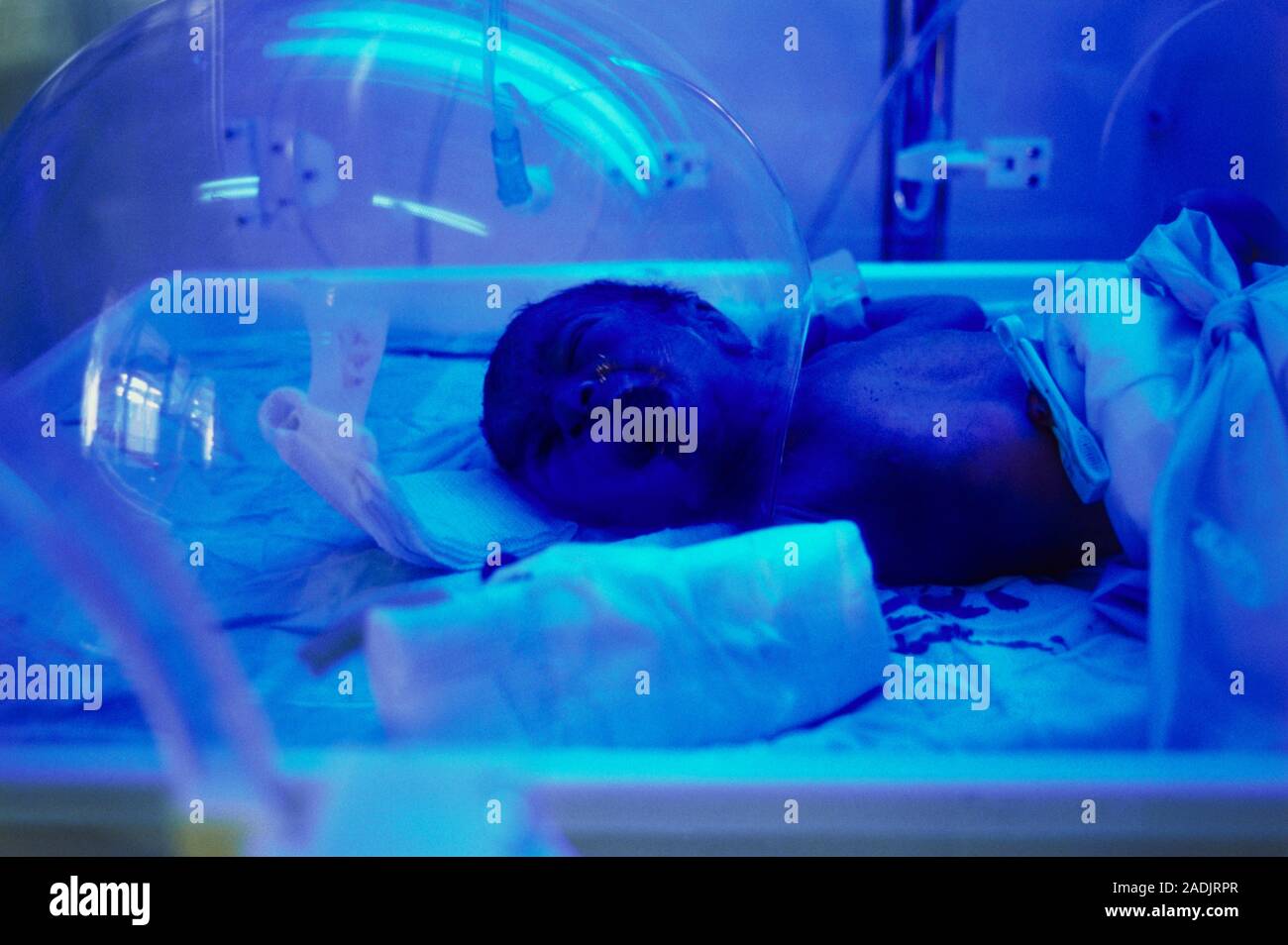 Jaundice baby treatment. View of a newborn baby in an incubator ...