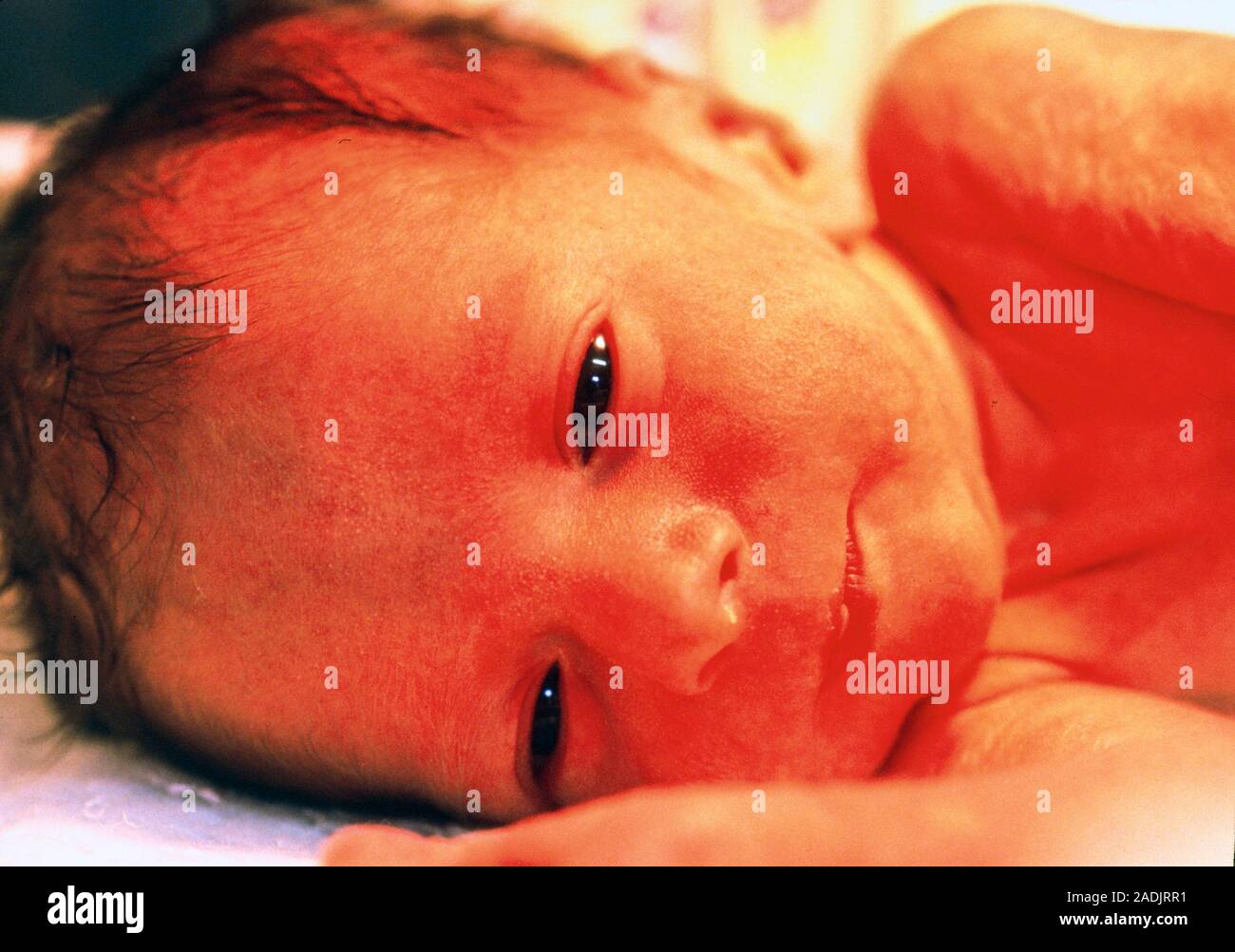 Premature baby. View of the face of a premature baby. Premature babies ...