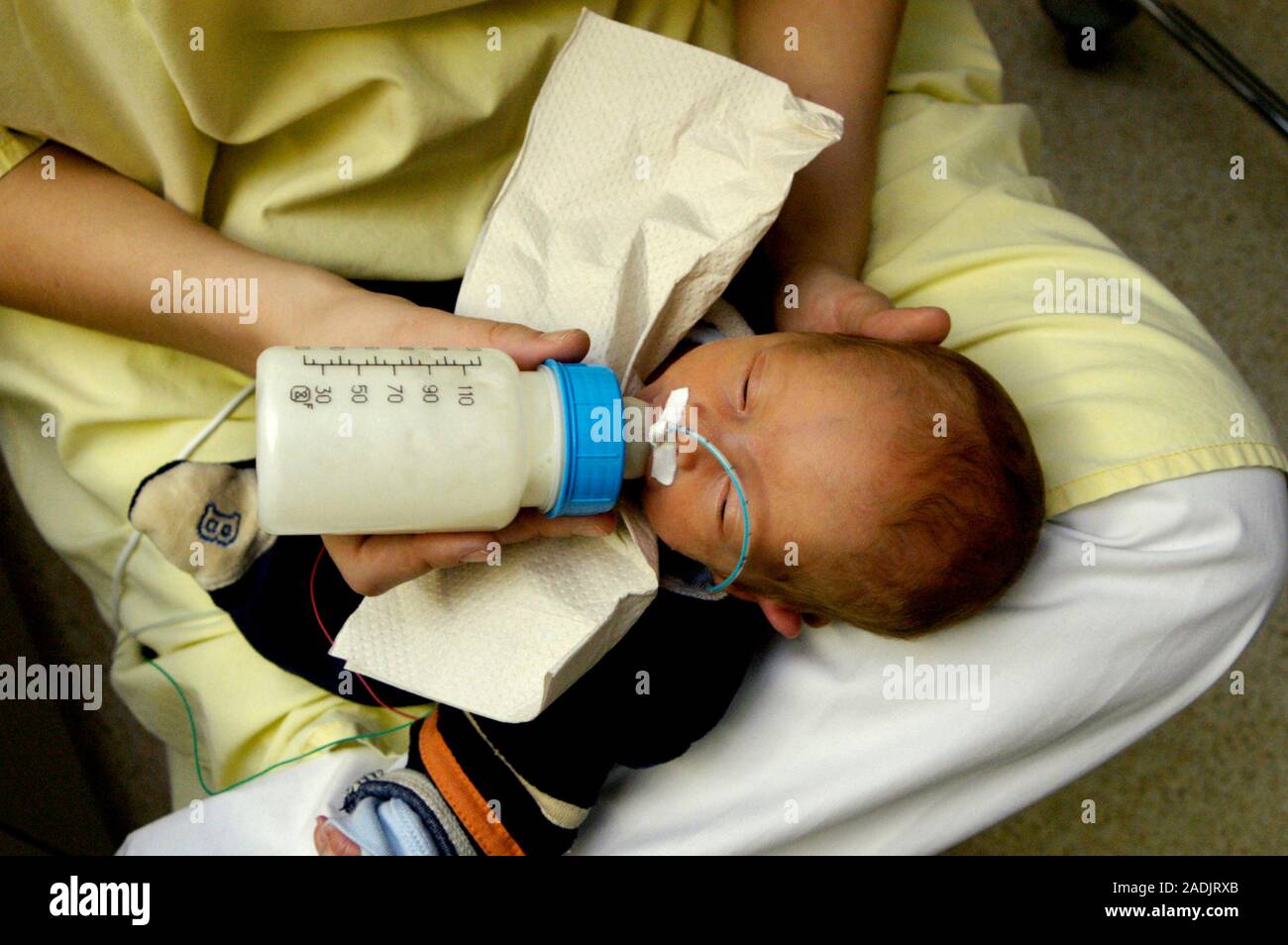 MODEL RELEASED. Jaundiced premature baby being bottle-fed. Jaundice is ...