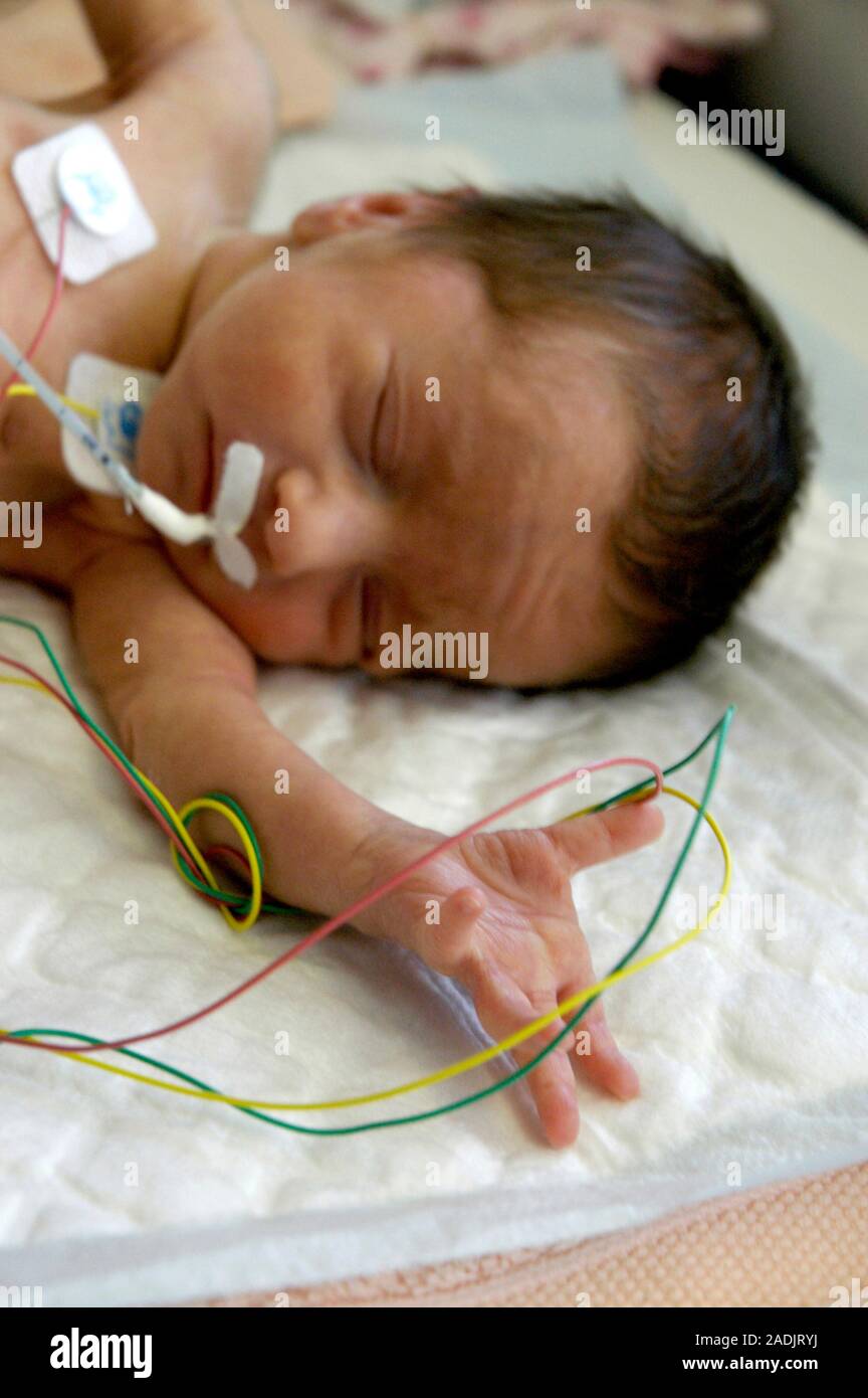 Sleeping premature baby. The wires around its hand come from ...